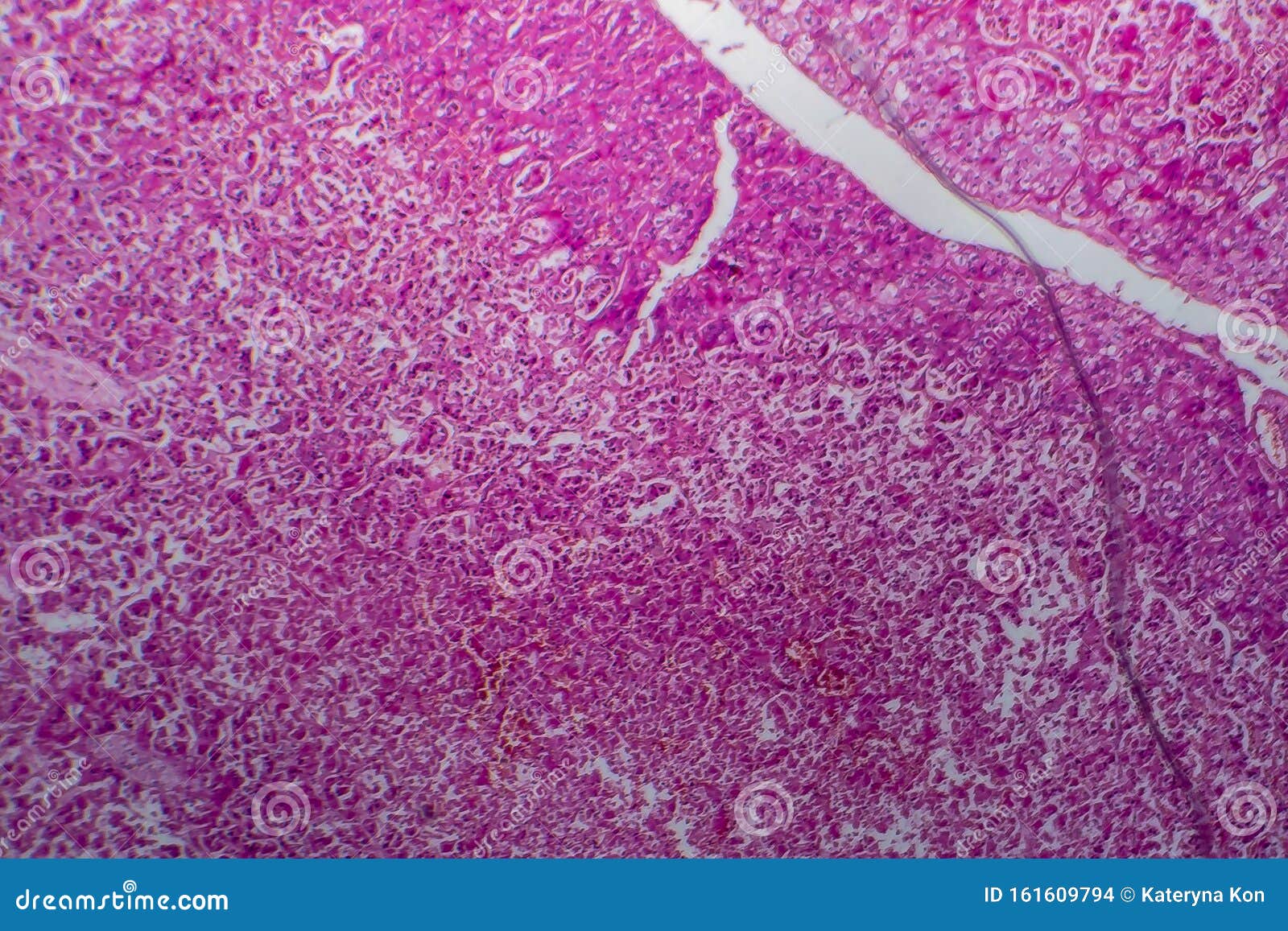 Renal Cell Carcinoma, Light Micrograph Stock Photo - Image of ...