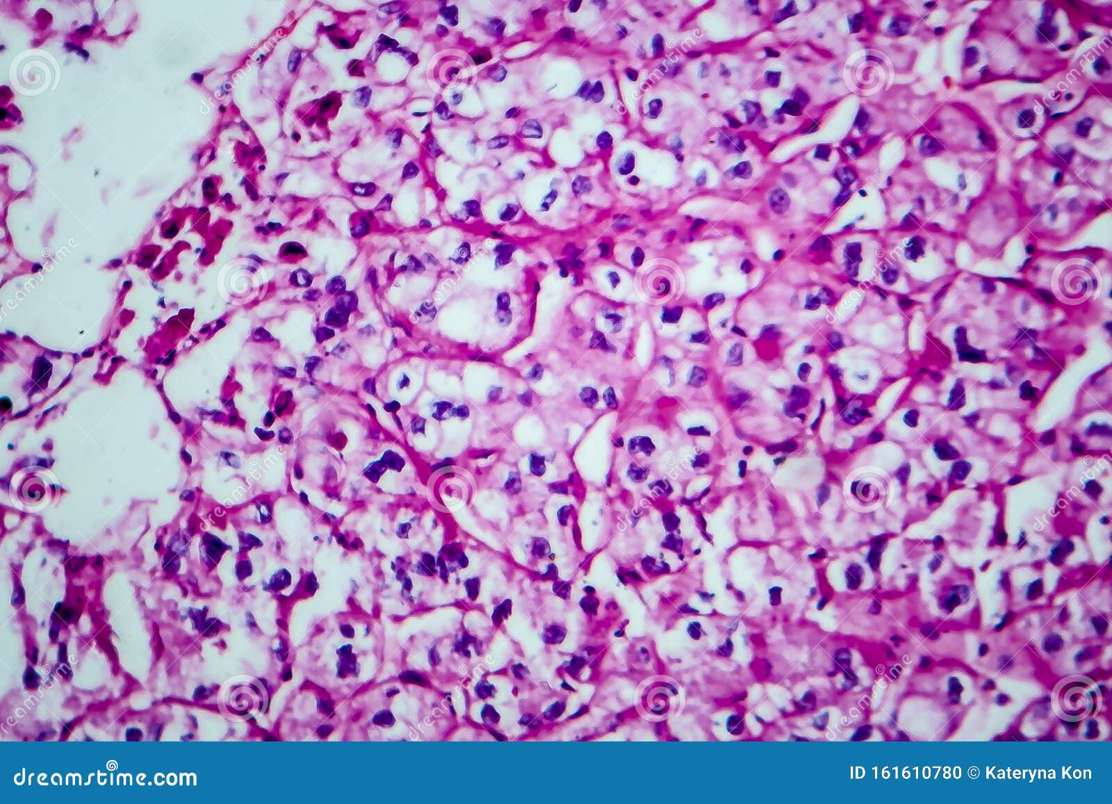 Renal Cell Carcinoma, Light Micrograph Stock Photo - Image of neoplasia ...