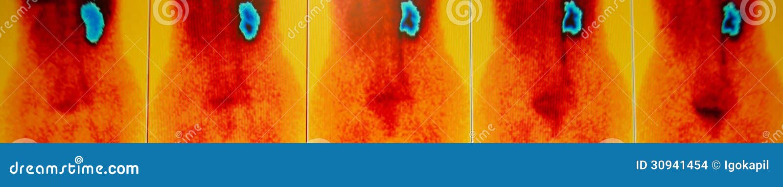 Pelvic Nuclear Medicine Bone Scan - Normal Image Stock Photography ...