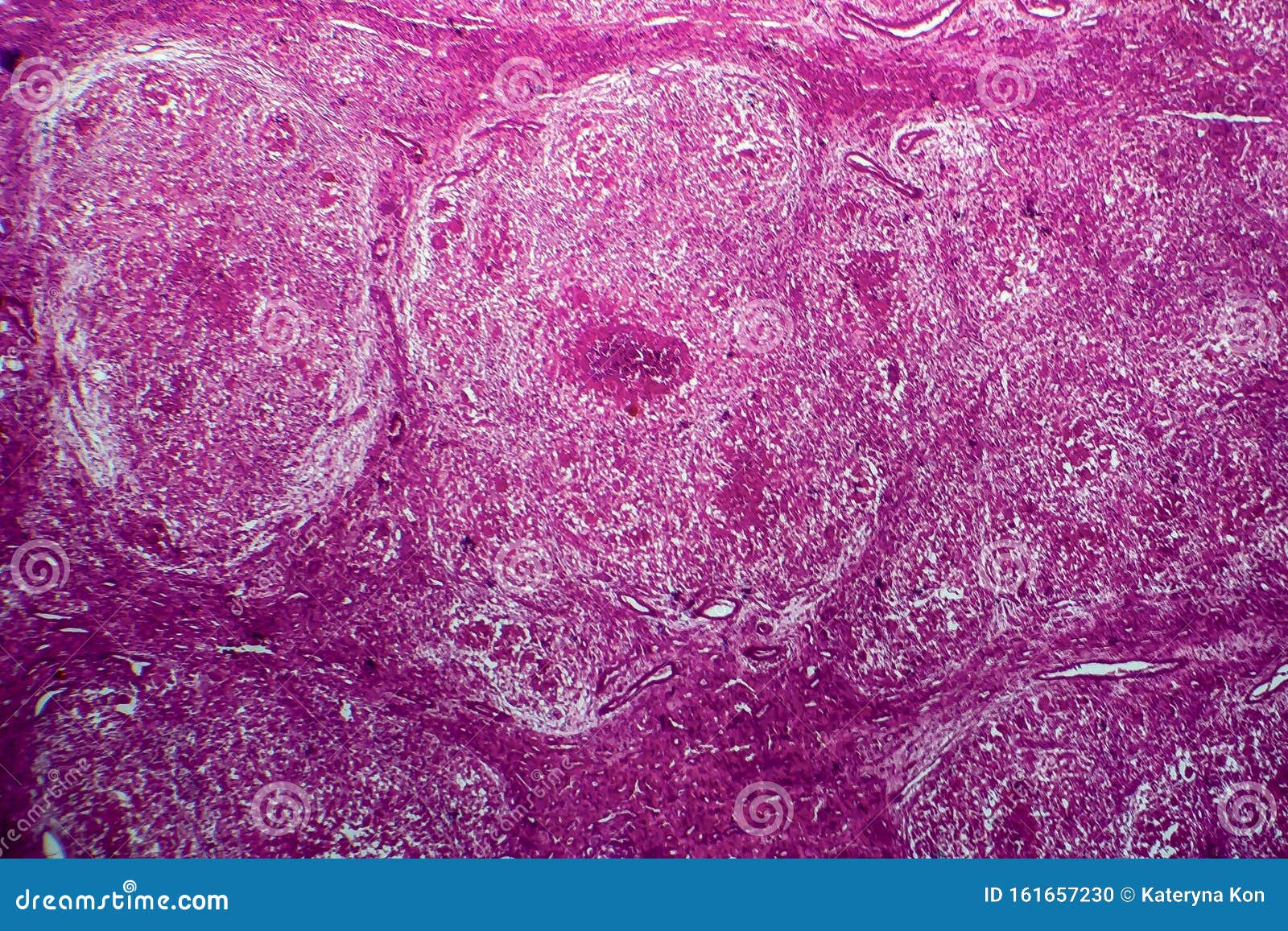 Renal Tuberculosis, Light Micrograph Stock Photo - Image of morphology ...