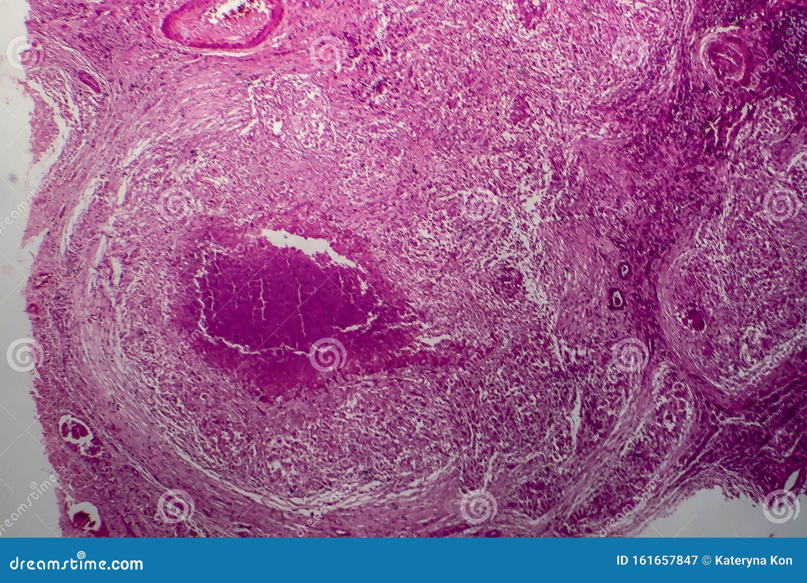 Renal Tuberculosis, Light Micrograph Stock Image - Image of medical ...