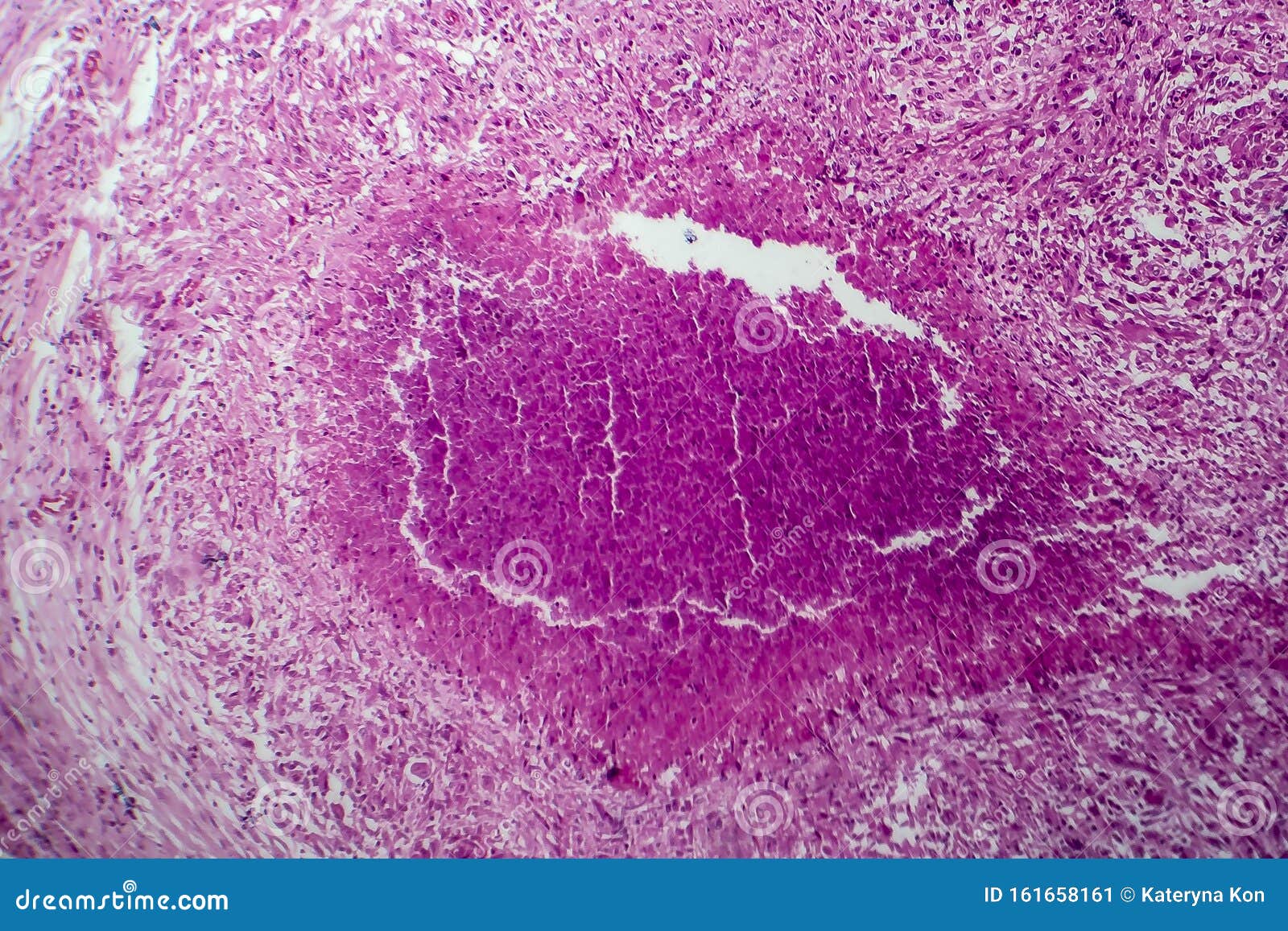 Renal Tuberculosis, Light Micrograph Royalty-Free Stock Photography ...