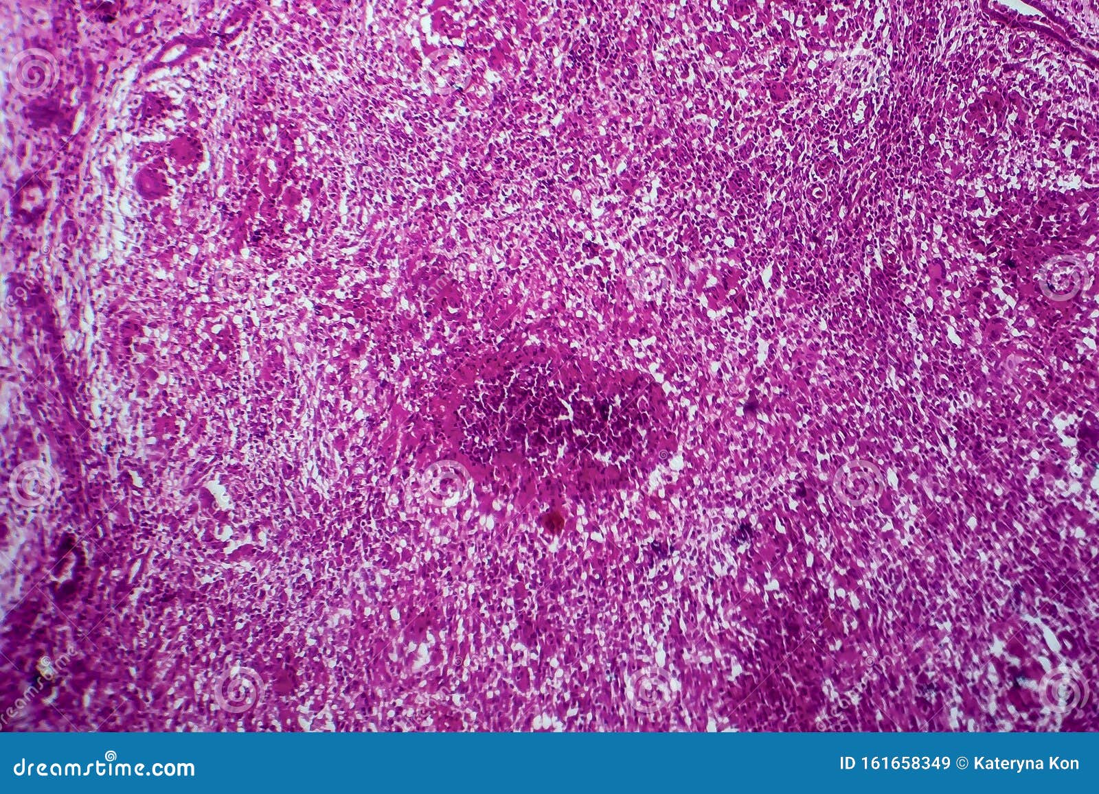 Renal Tuberculosis, Light Micrograph Stock Image - Image of cell ...
