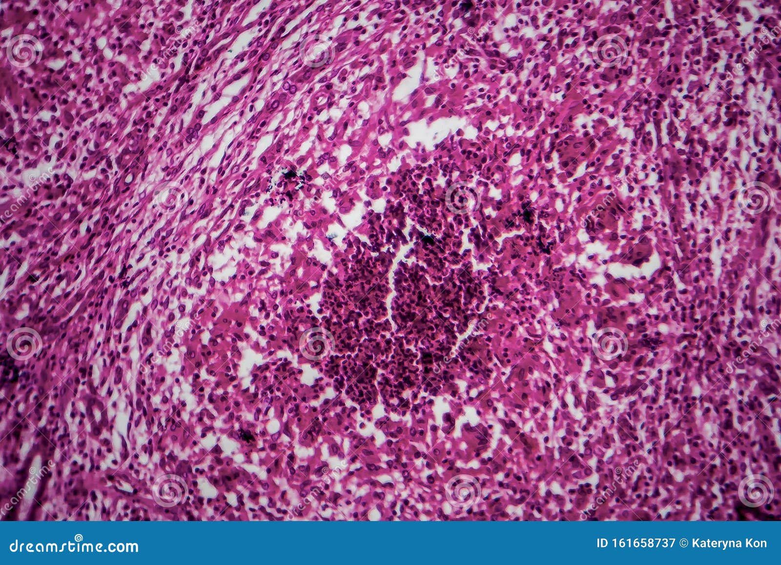Renal Tuberculosis, Light Micrograph Stock Image - Image of morphology ...
