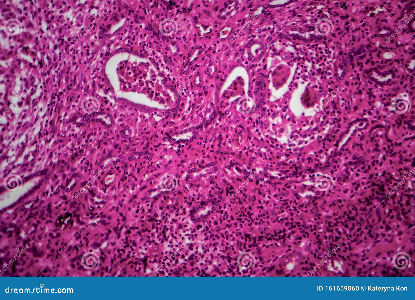 Renal Tuberculosis, Light Micrograph Stock Photo - Image of renal ...