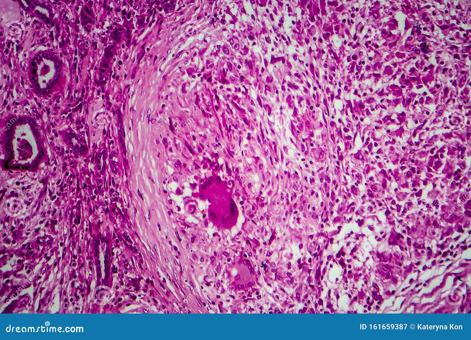 Renal Tuberculosis, Light Micrograph Stock Image - Image of ...