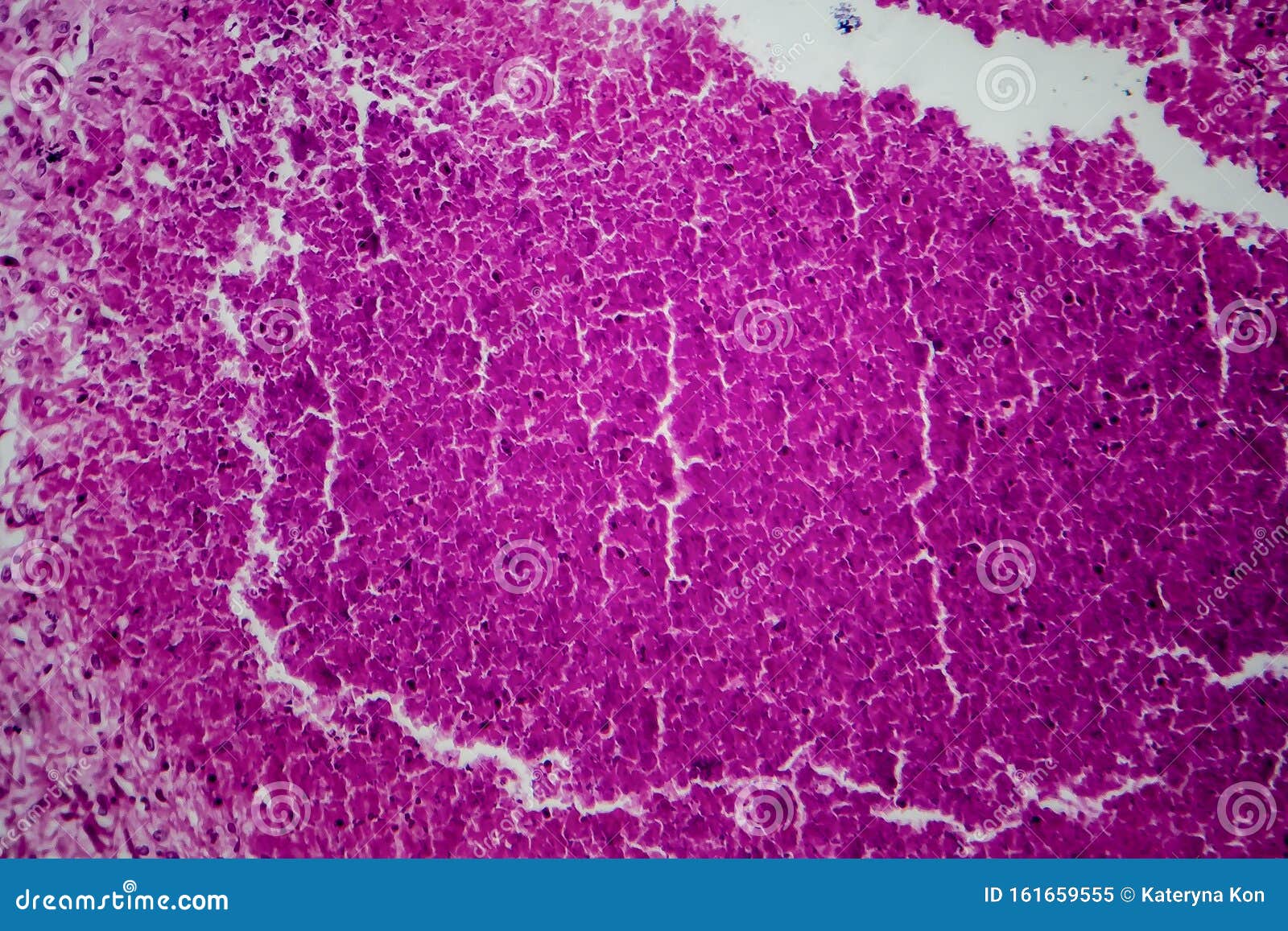 Renal Tuberculosis, Light Micrograph Stock Image - Image of hematoxylin ...
