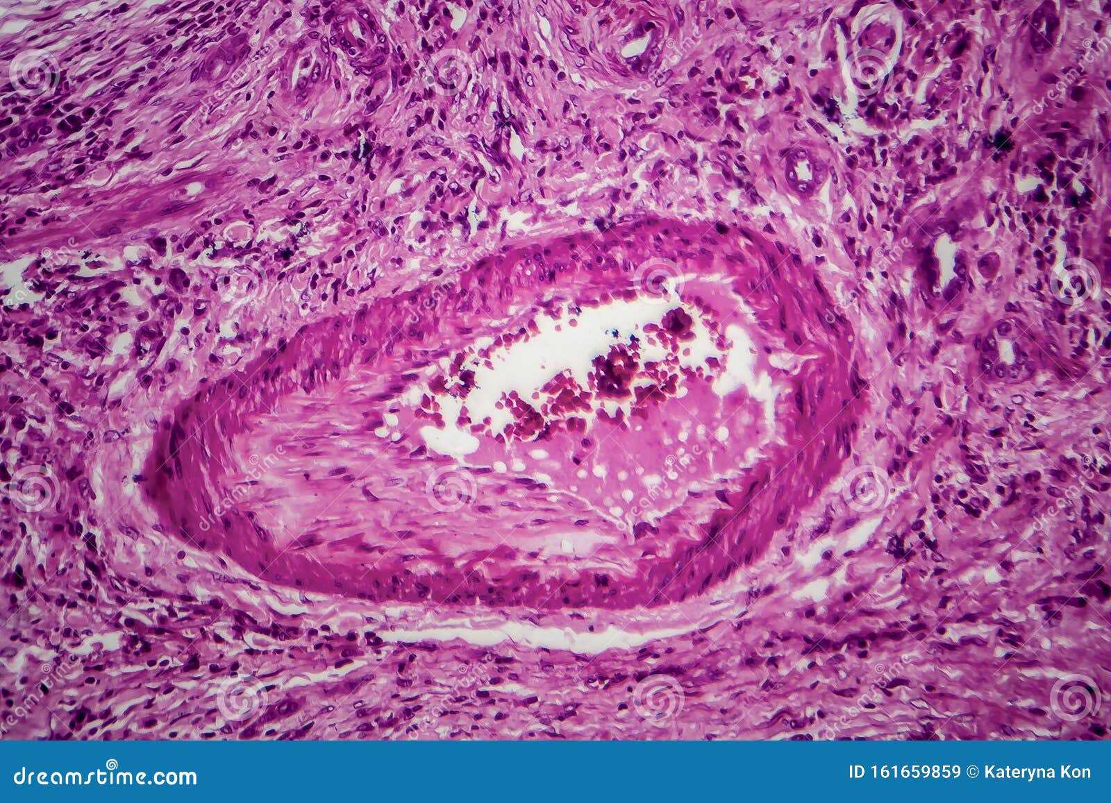 Renal Tuberculosis, Light Micrograph Stock Image - Image of medicine ...