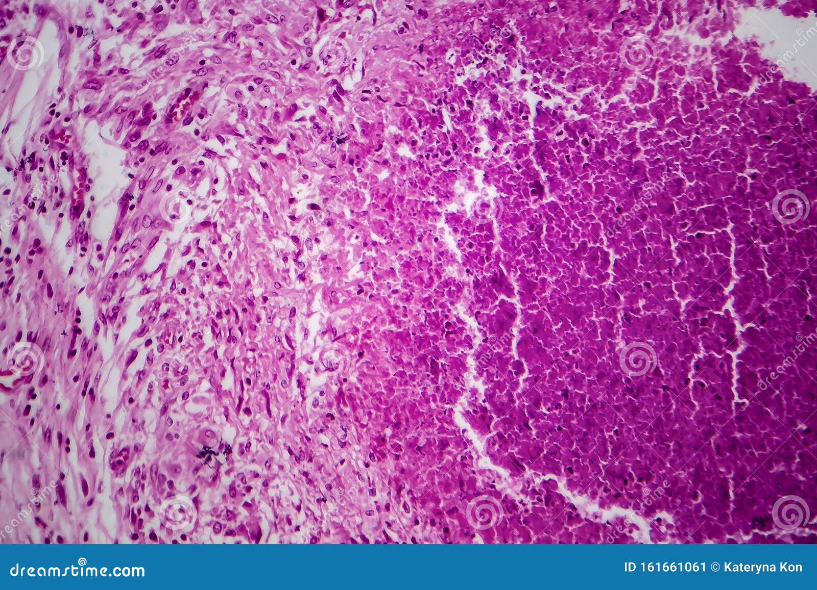 Renal Tuberculosis, Light Micrograph Stock Image - Image of pathology ...