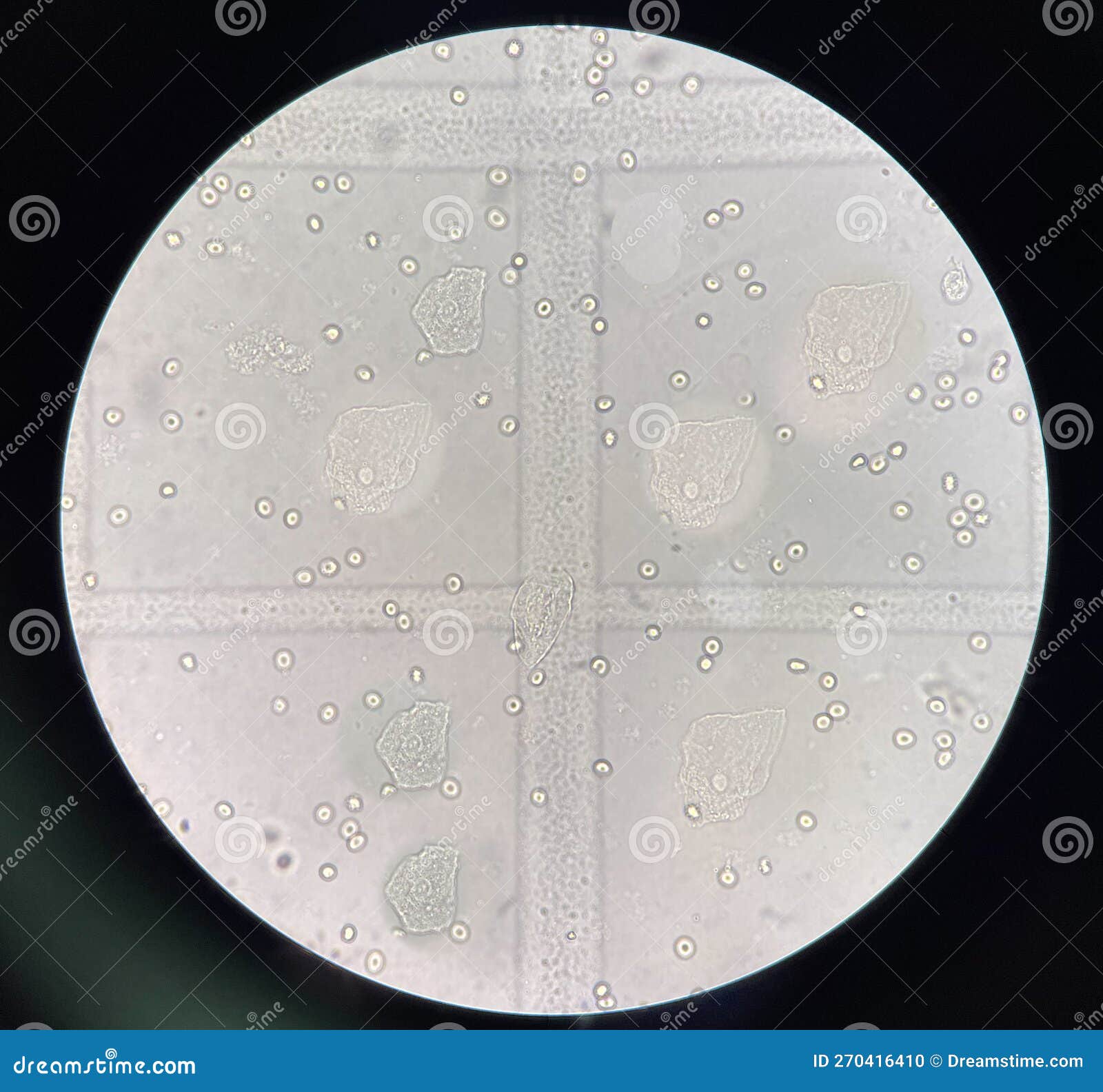 Renale Epitheelcel Met Rbc in Urine Stock Foto - Image of menselijk ...