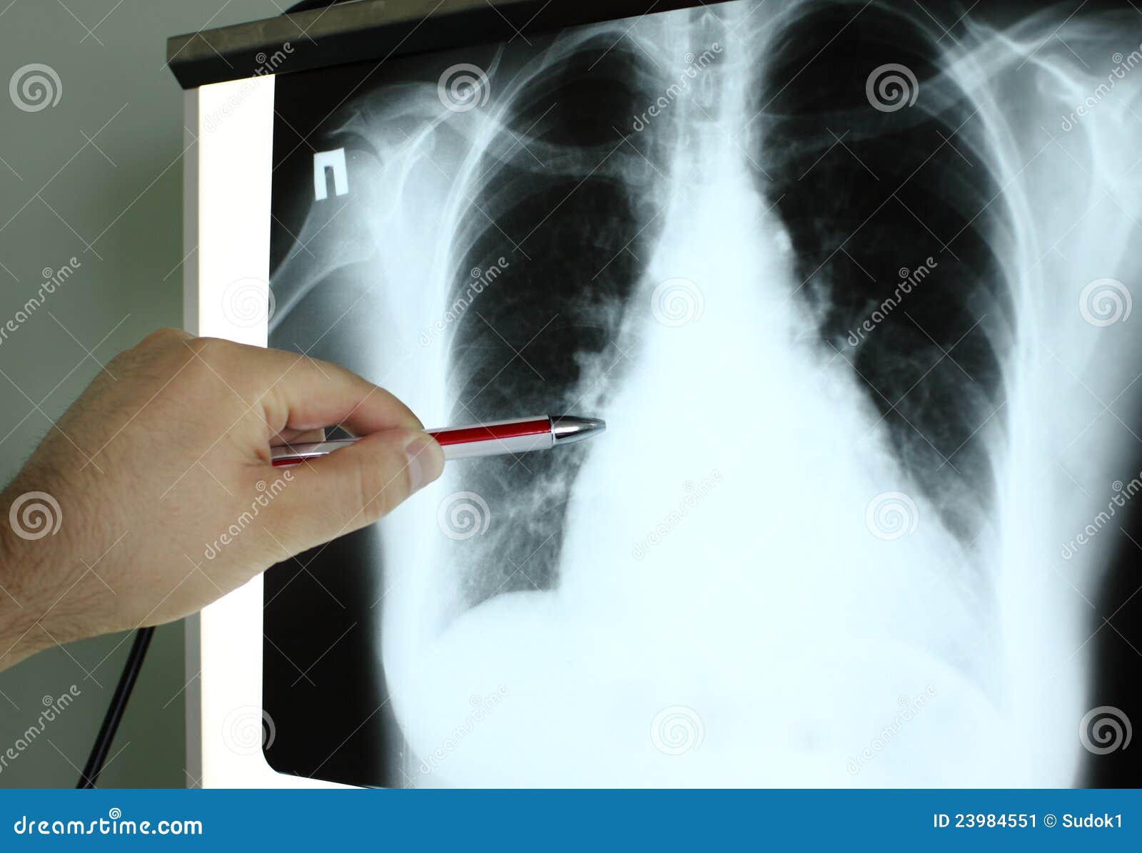 Rentgen the Lungs and the Doctor S Hand with Pen. Stock Image - Image ...