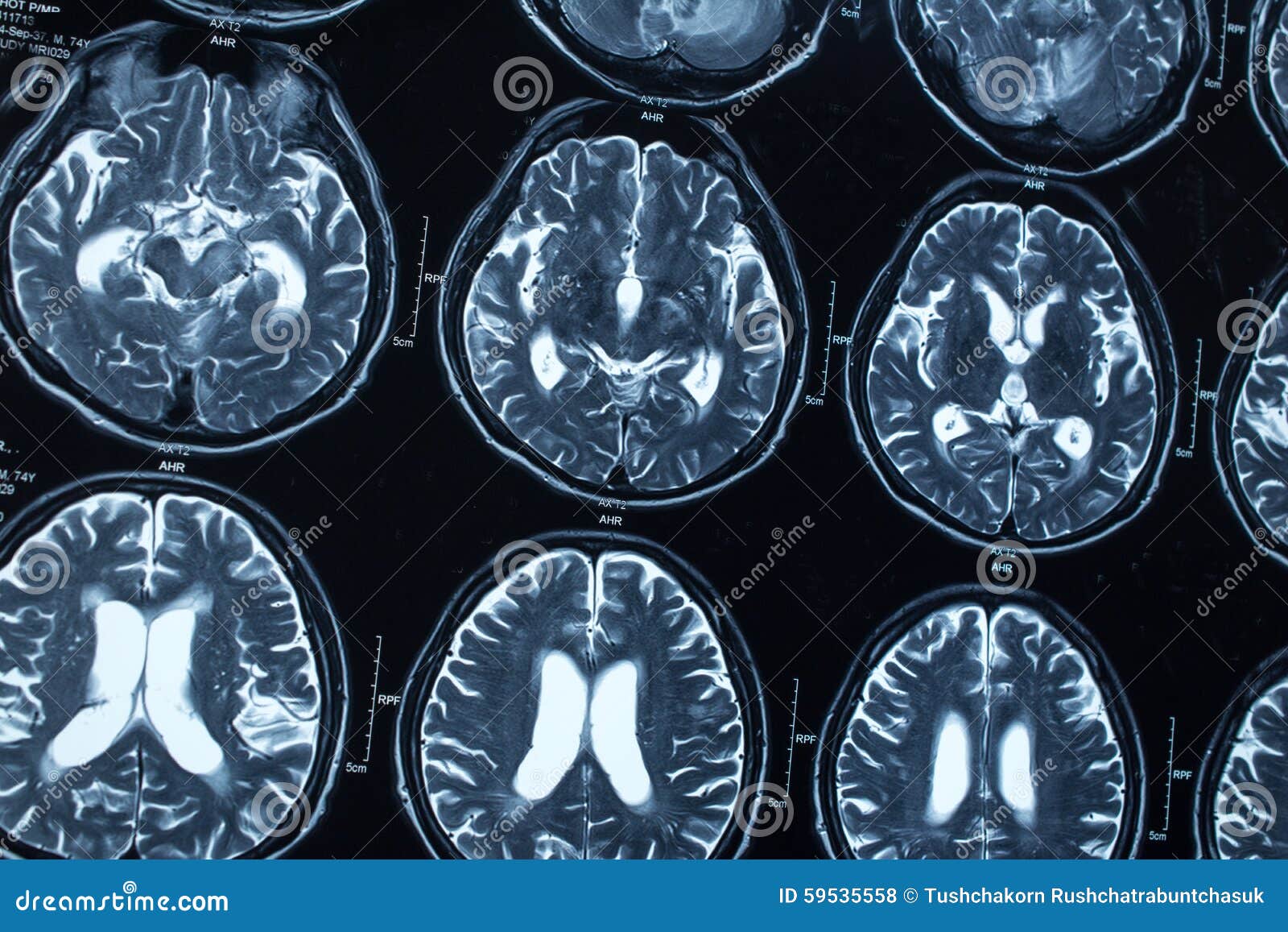 Research in Medicine. CT Scan of the Patient Stock Photo - Image of ...