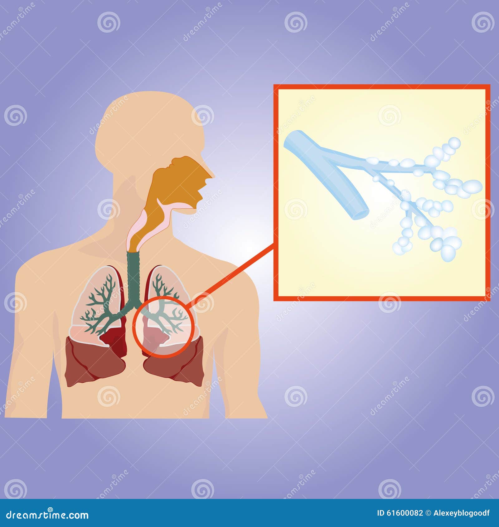Respiratory System. Bronchi Increased Stock Vector - Illustration of ...