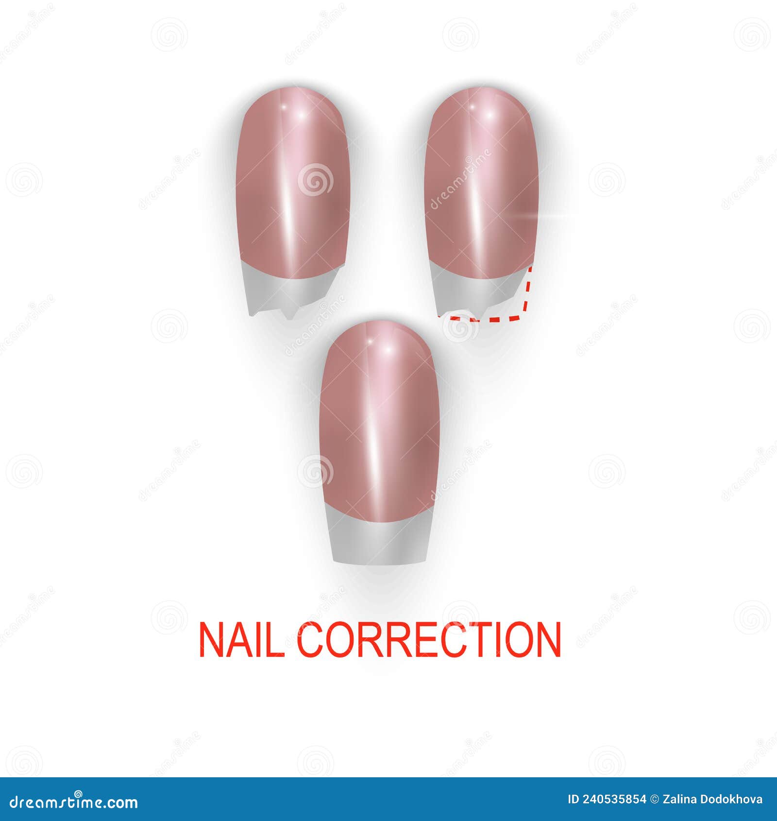 Concave Nail Plate Type, Nail Growth Direction, Upward Growing, Vector ...