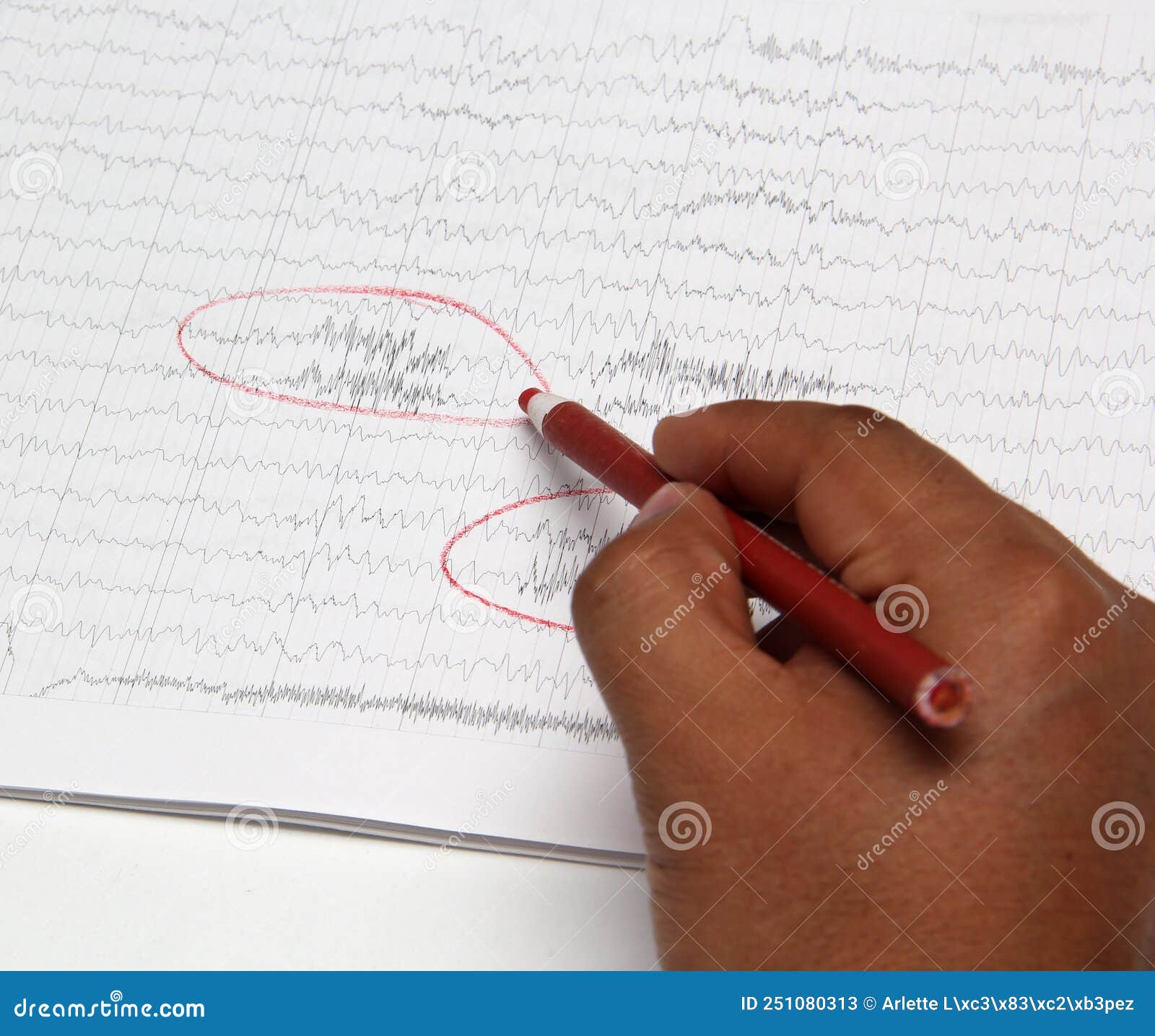 Results of an Electroencephalogram after a Neurophysiological ...