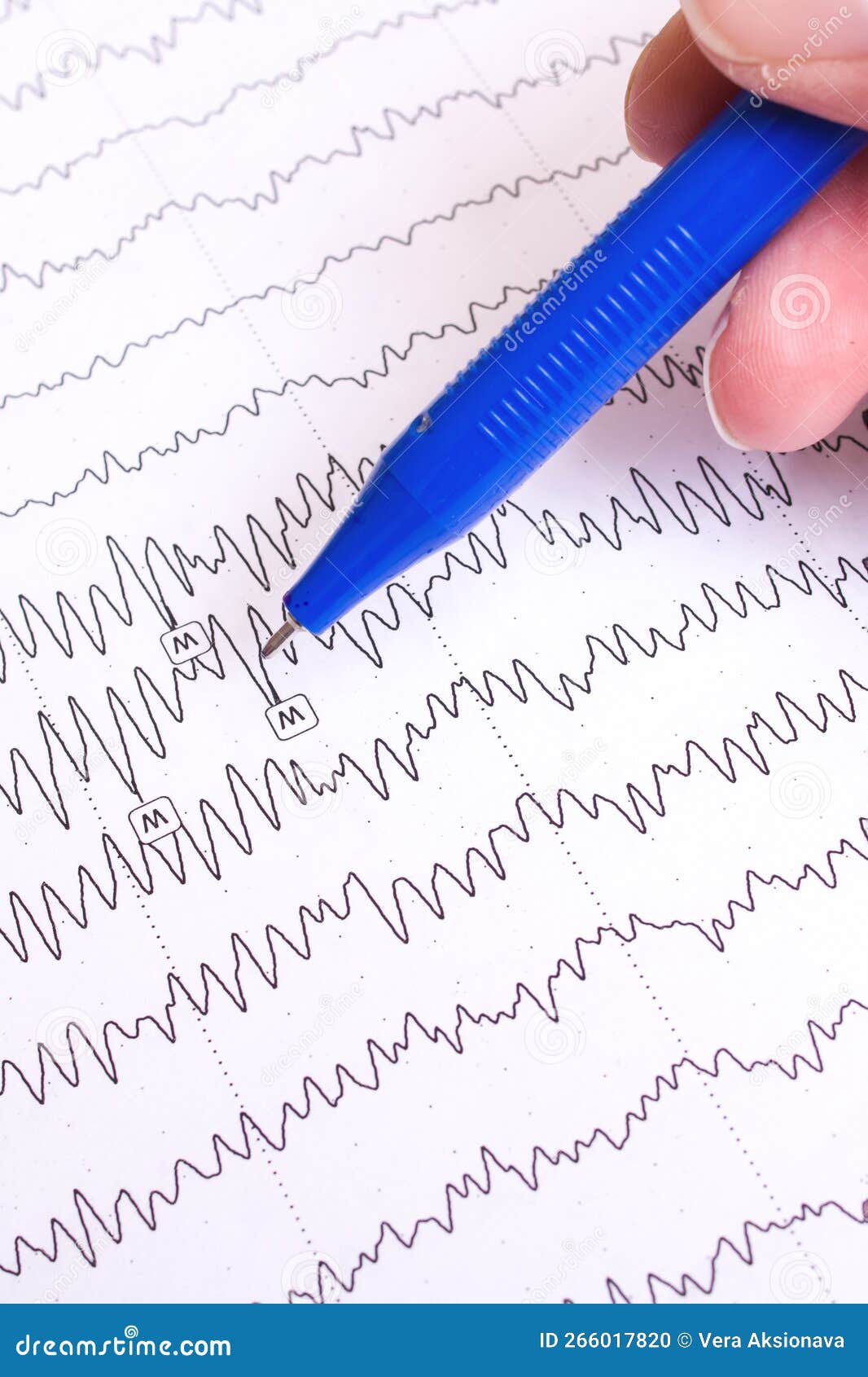 Results of Electroencephalogram on Paper, Diagnostics of Epilepsy Stock ...