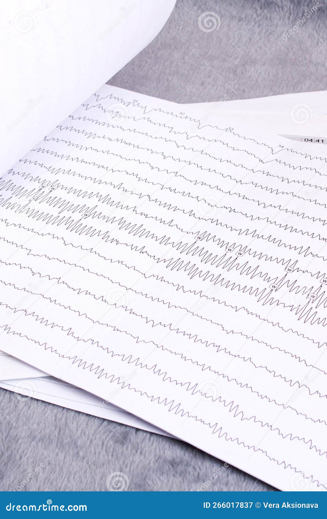 Results of Electroencephalogram on Paper, Diagnostics of Epilepsy Stock ...