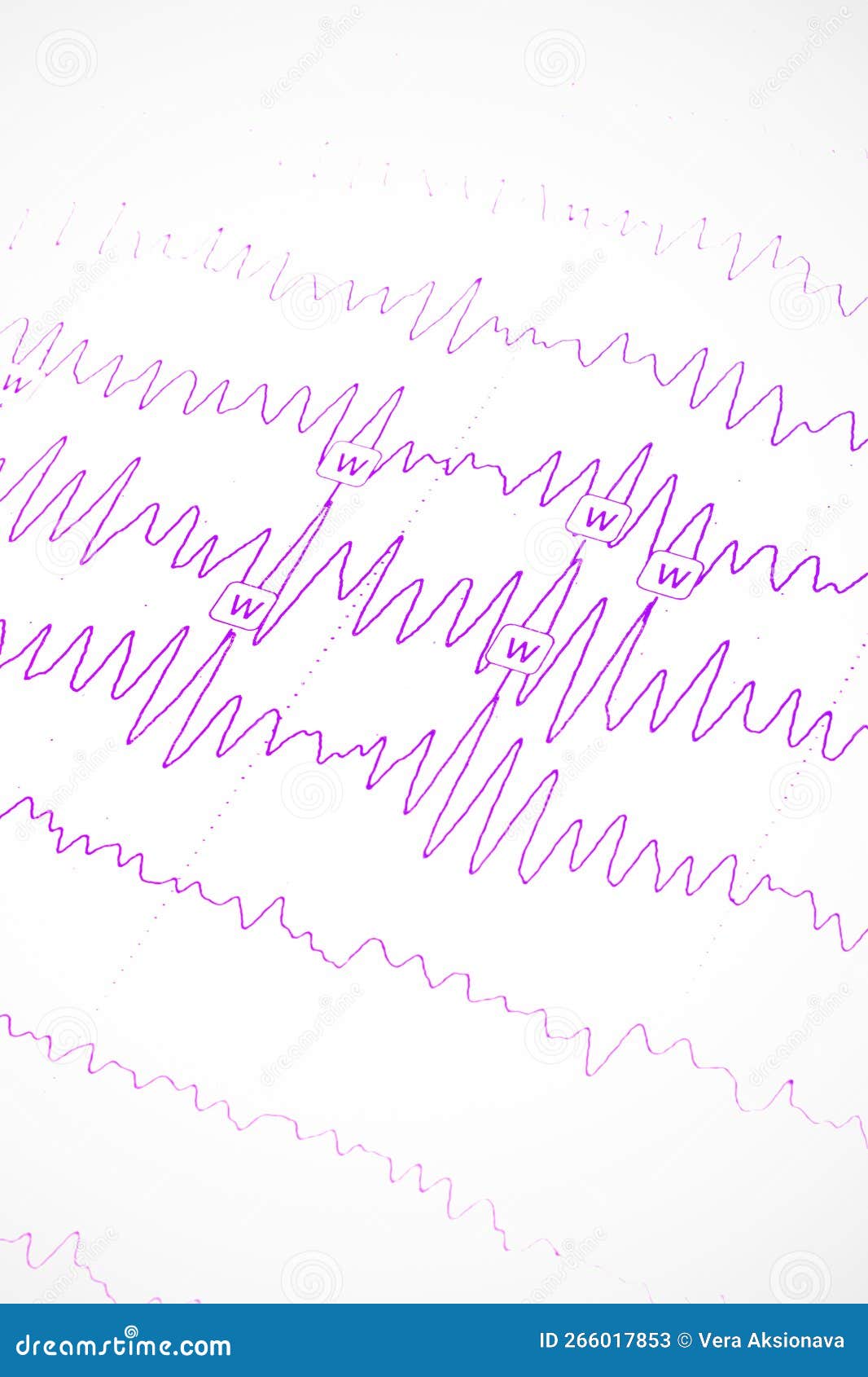 Results of Electroencephalogram on Paper, Diagnostics of Epilepsy Stock ...