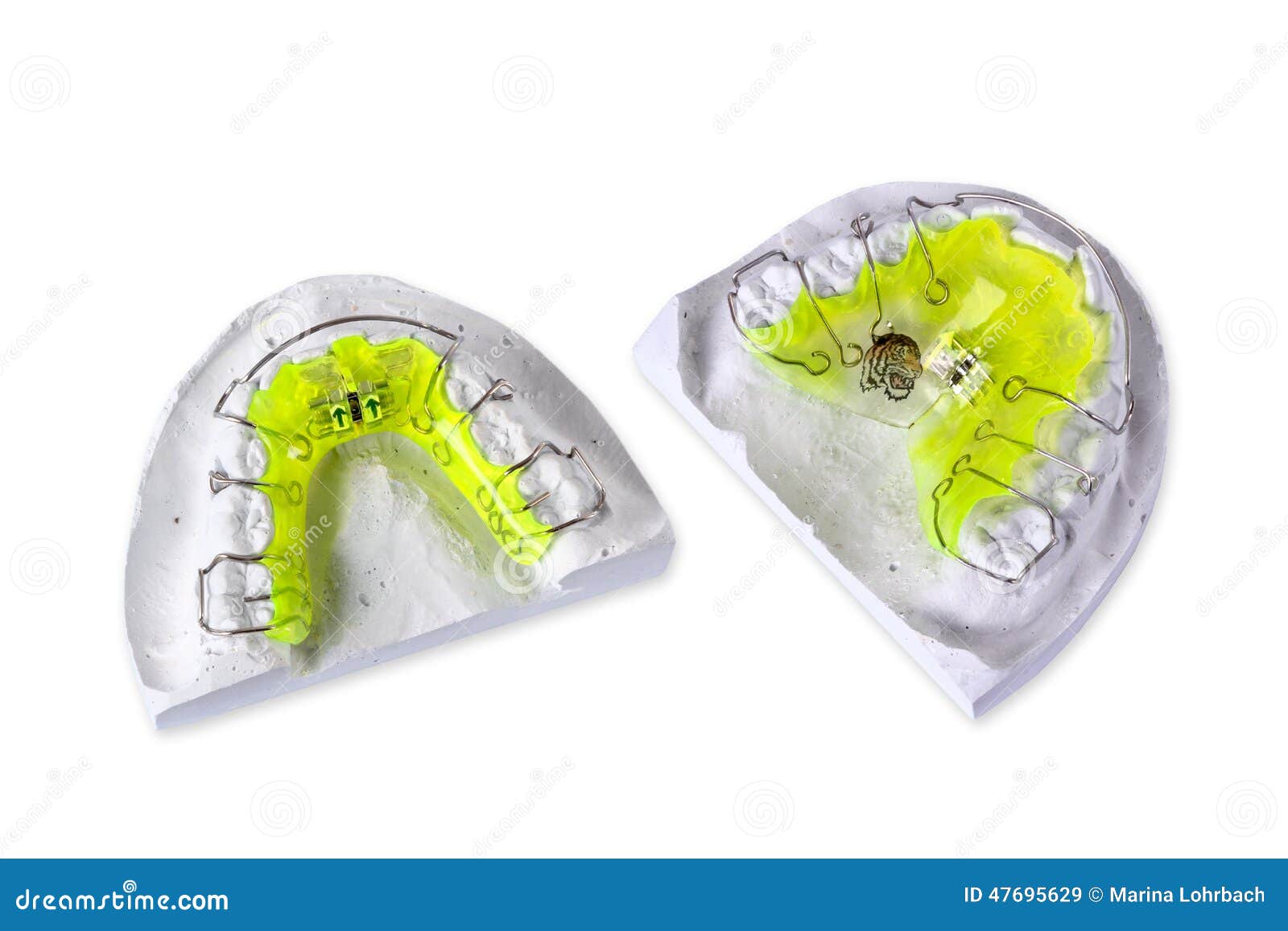 Retainer with plaster cast stock image. Image of loose - 47695629