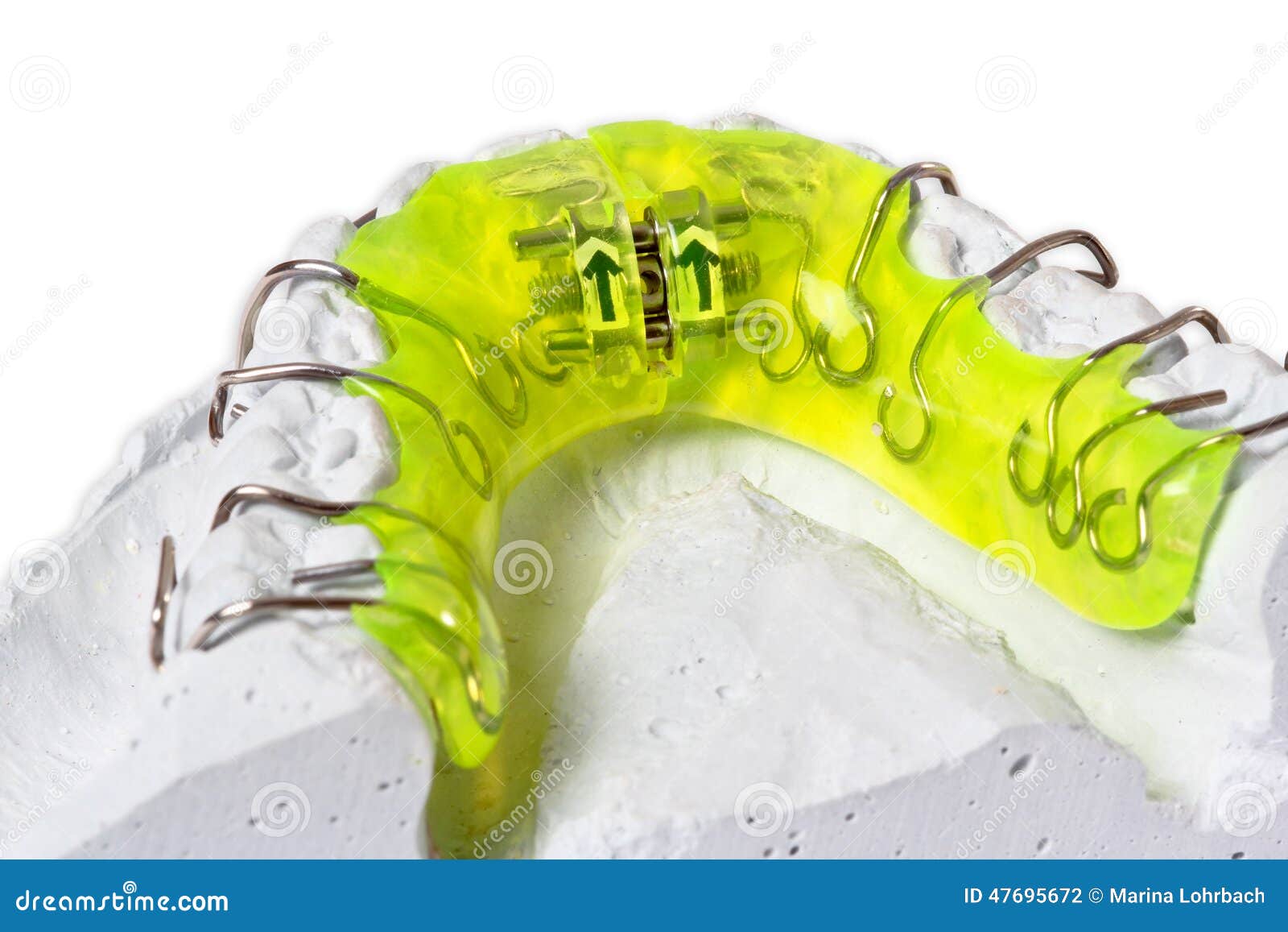 Retainer with plaster cast stock photo. Image of cure - 47695672