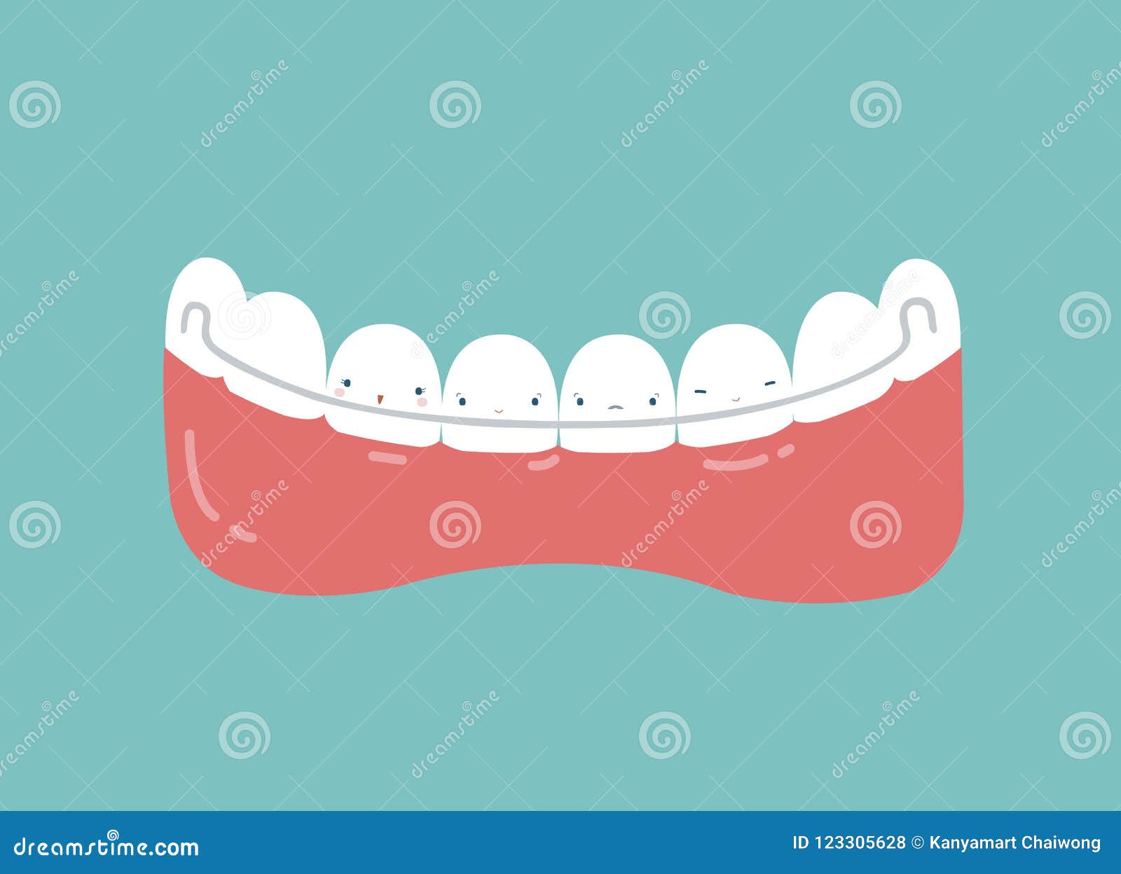 Retainers Dental Installed After Braces Treatment, Medically Accurate ...