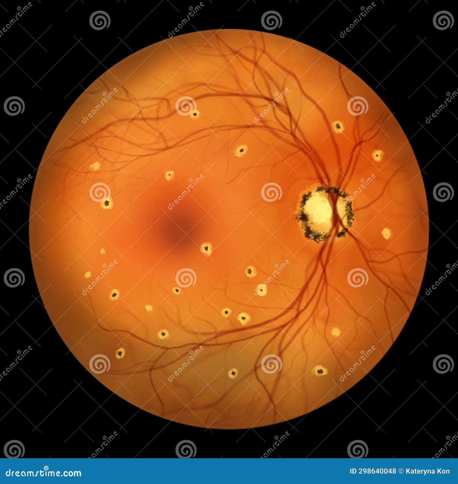 Retina In Ocular Histoplasmosis Syndrome Illustration Stock