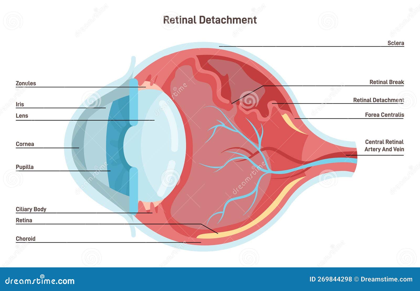 Retinal Detachment. Emergency Situation in Which a Thin Layer of Tissue ...