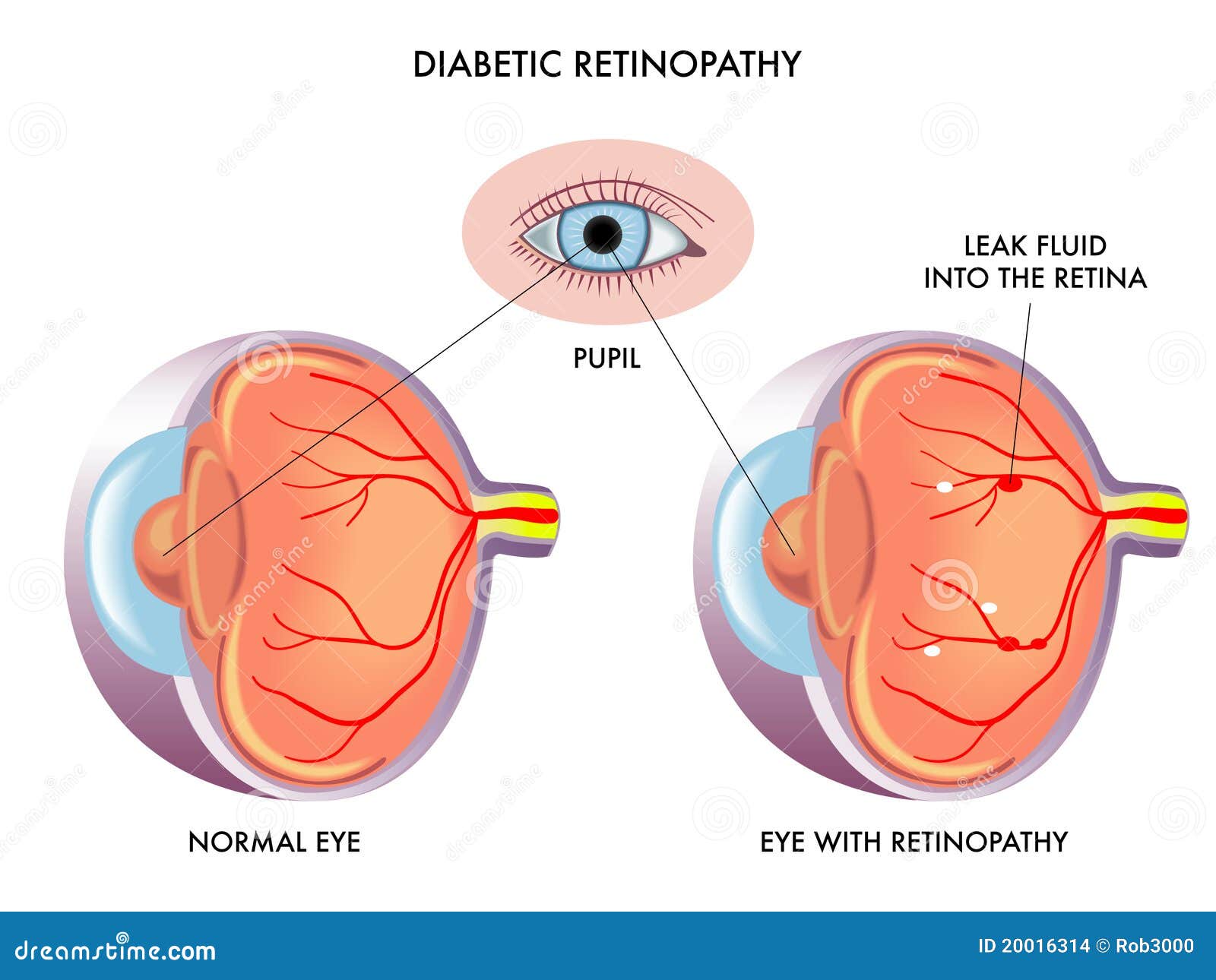Retinopathy do diabético ilustração do vetor. Ilustração de patologia ...