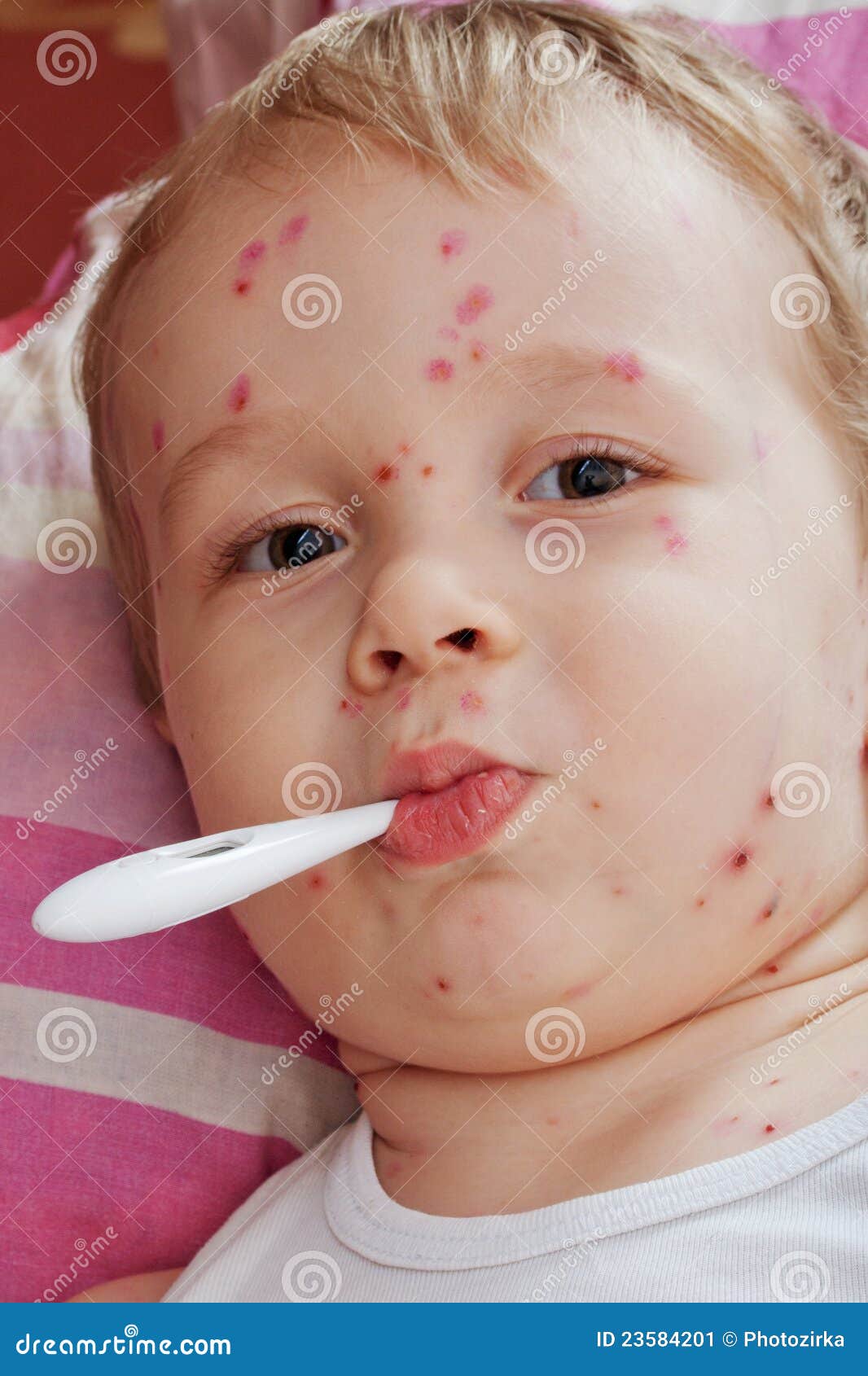 Retrato De Uma Criança Doente Imagem de Stock - Imagem de varicela ...