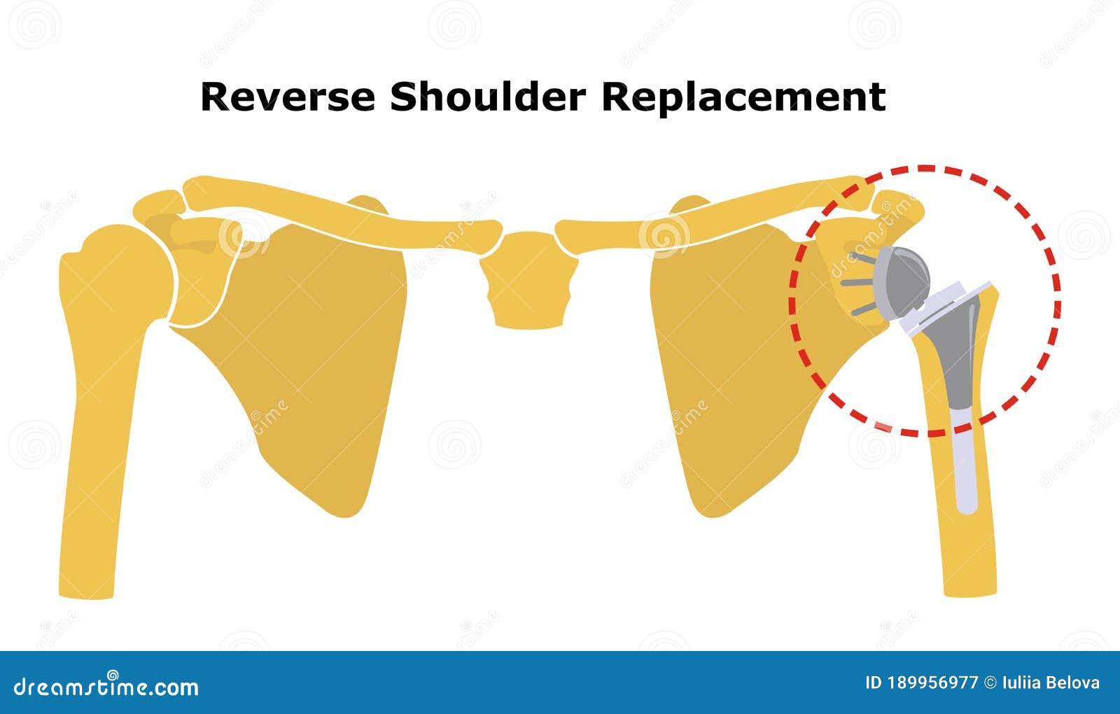 Reverse Shoulder Replacement. Shoulder Joint Replacement ...