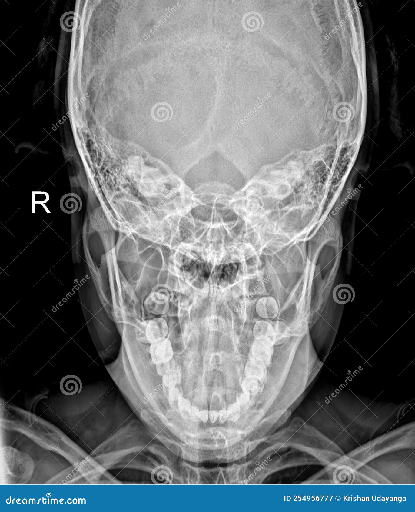 Reverse Towns PA View Radiograph Stock Image - Image of hospital ...