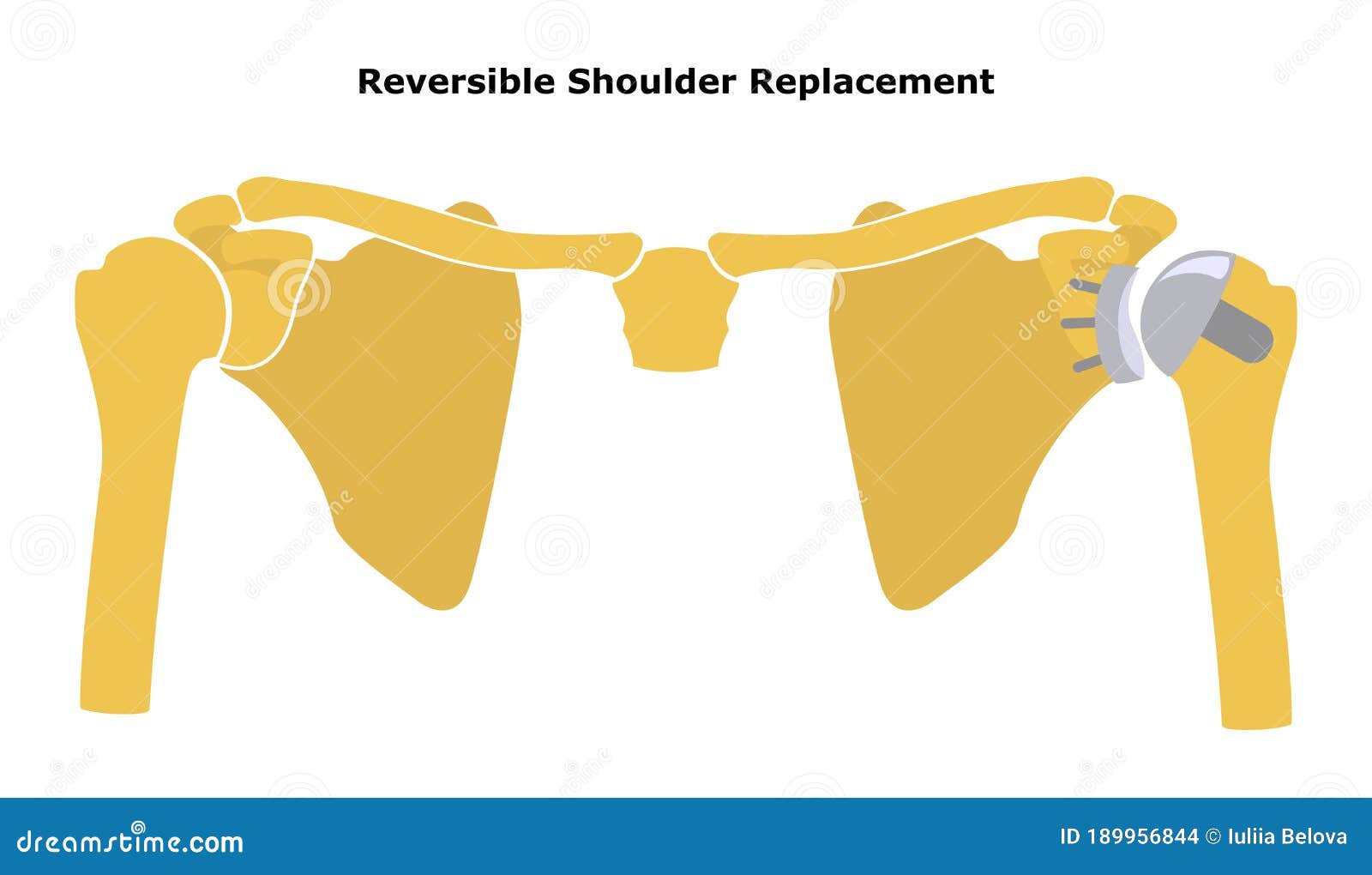 Reversible Shoulder Replacement. Shoulder Joint Replacement ...