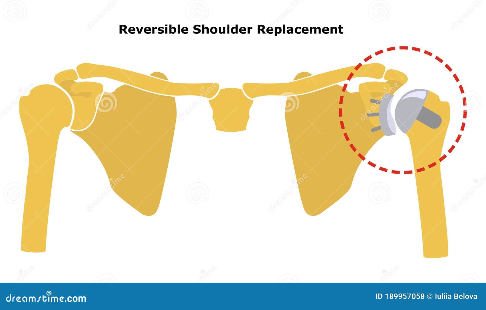 Reversible Shoulder Replacement. Shoulder Joint Replacement ...