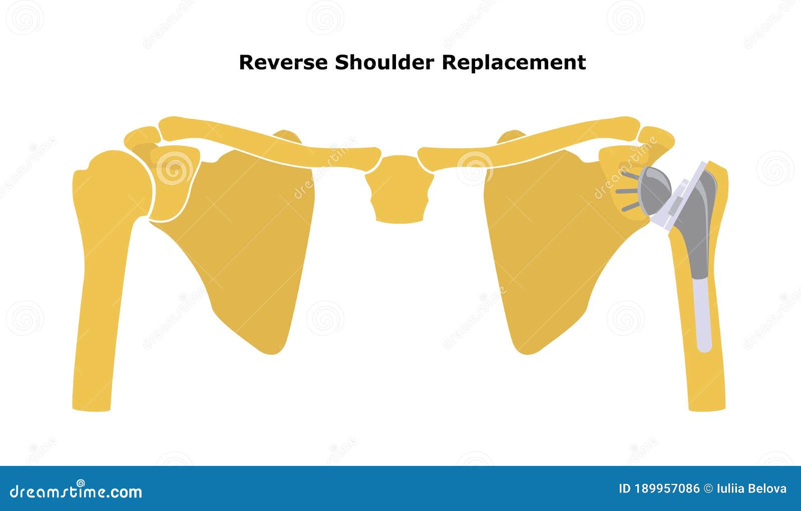 Reversible Shoulder Replacement. Shoulder Joint Replacement ...