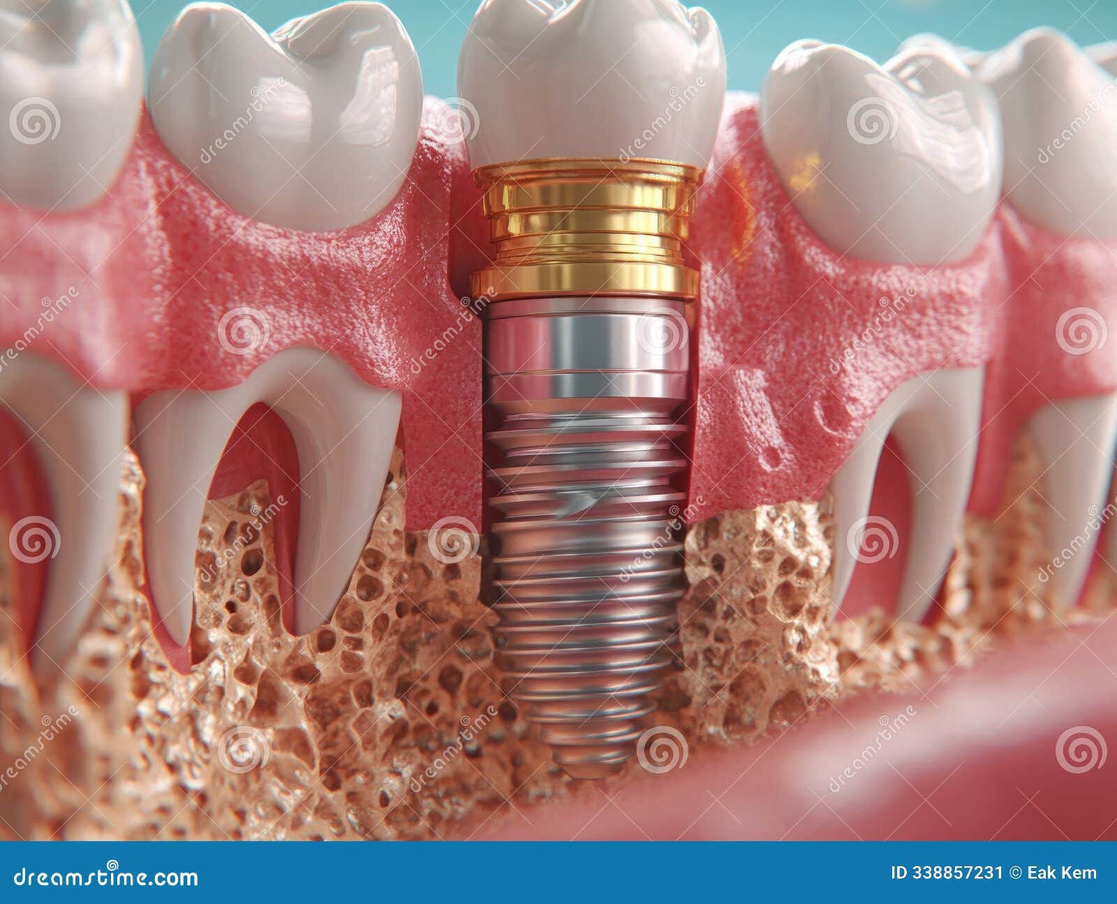 Revolutionizing Tooth Restoration 3D-Printed Components for Precision ...
