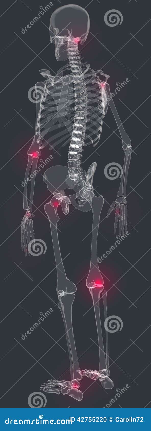 Rheumatism Or Rheumatic Disorder Medical Posters. Arthritis Joint Pain ...