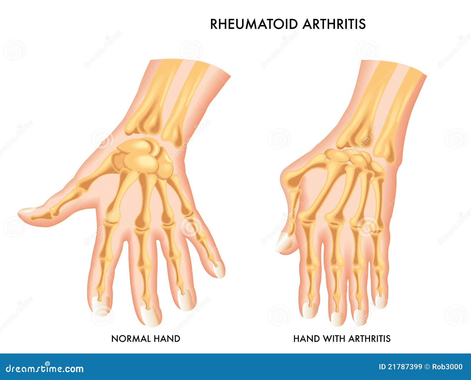 Rheumatoid Arthritis stock vector. Illustration of deformation - 21787399