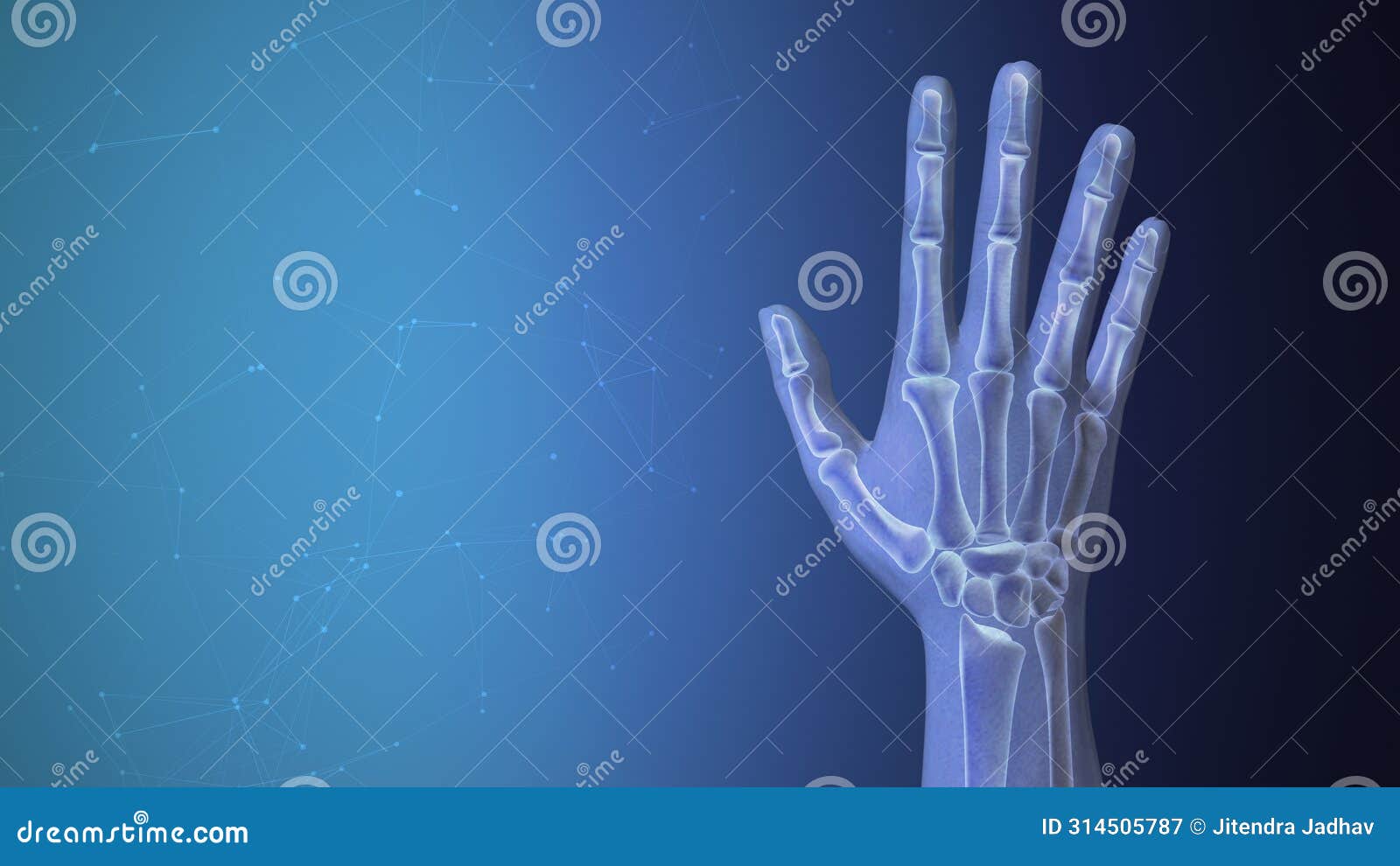 Rheumatoid Arthritis or Autoimmune Disorder Stock Illustration ...