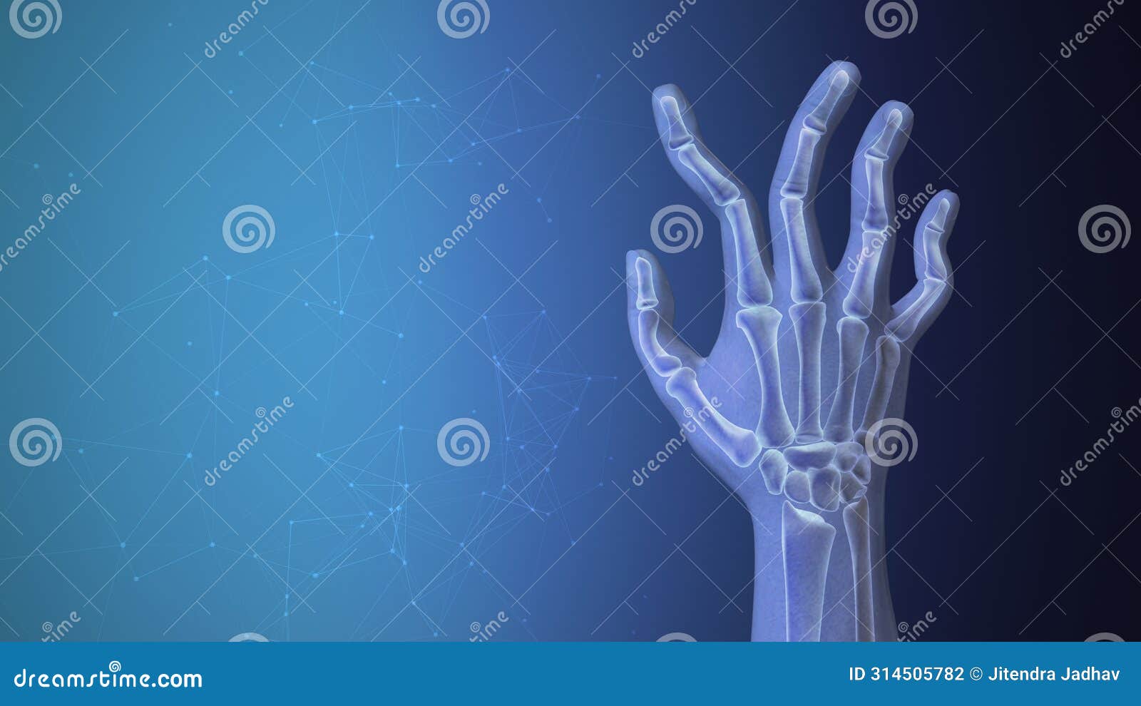 Rheumatoid Arthritis or Autoimmune Disorder Stock Illustration ...
