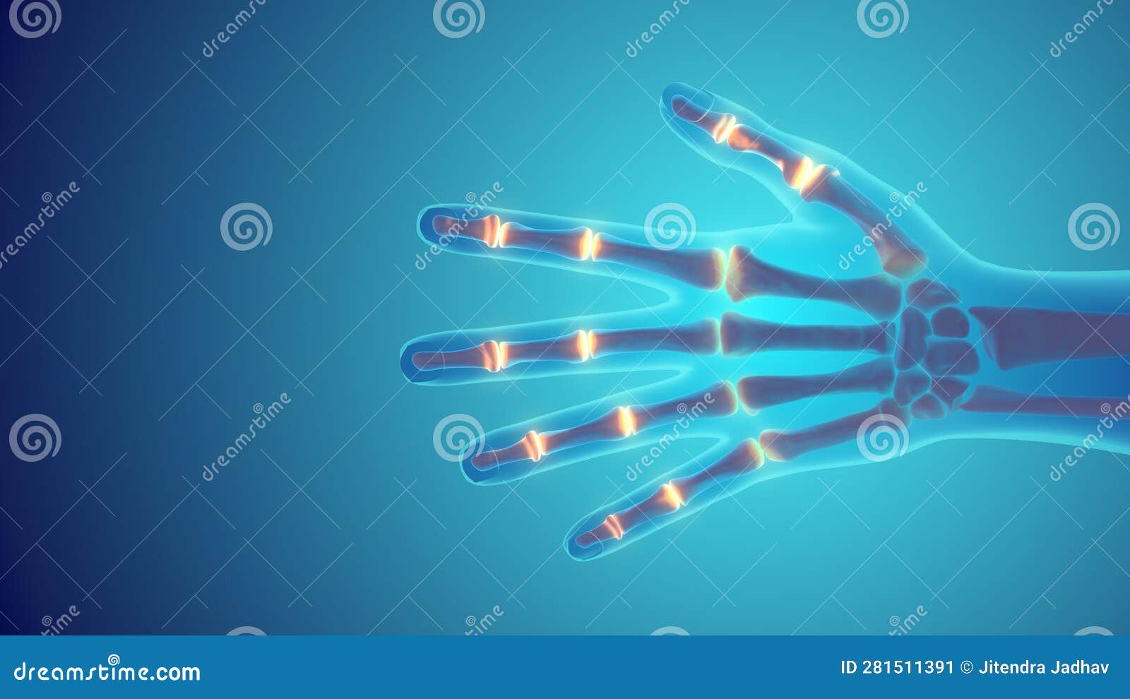 Rheumatoid Arthritis or Autoimmune and Inflammatory Disease Stock ...