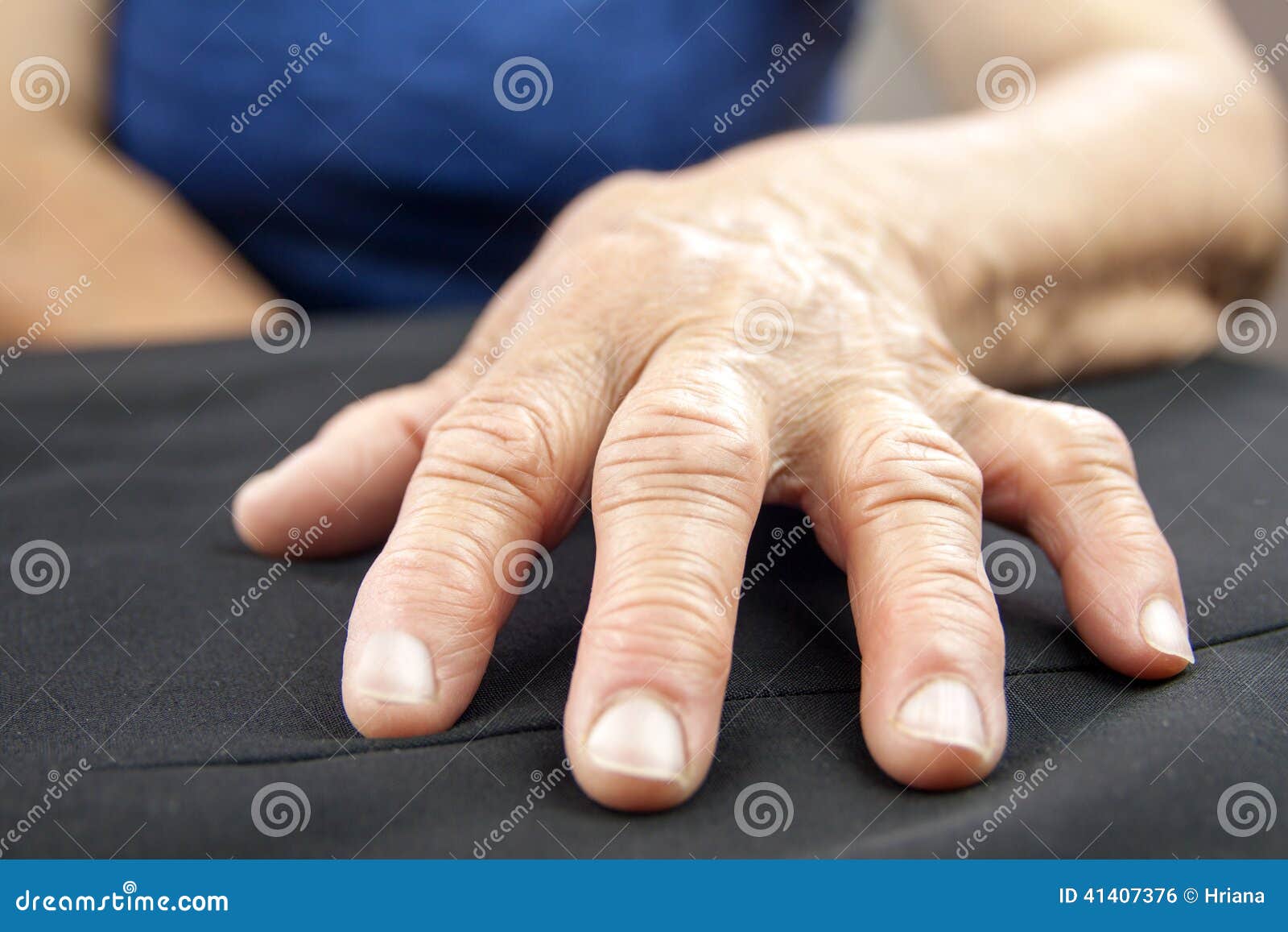Rheumatoid Arthritis hand stock photo. Image of macro - 41407376
