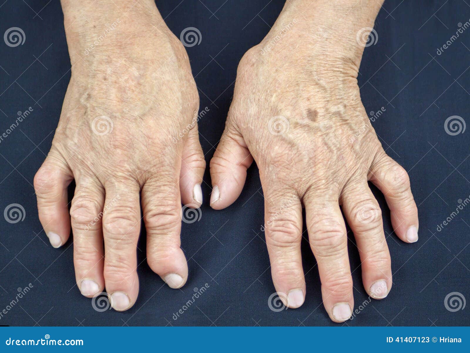 Rheumatoid Arthritis Hands Stock Image Image Of Fingers 41407123
