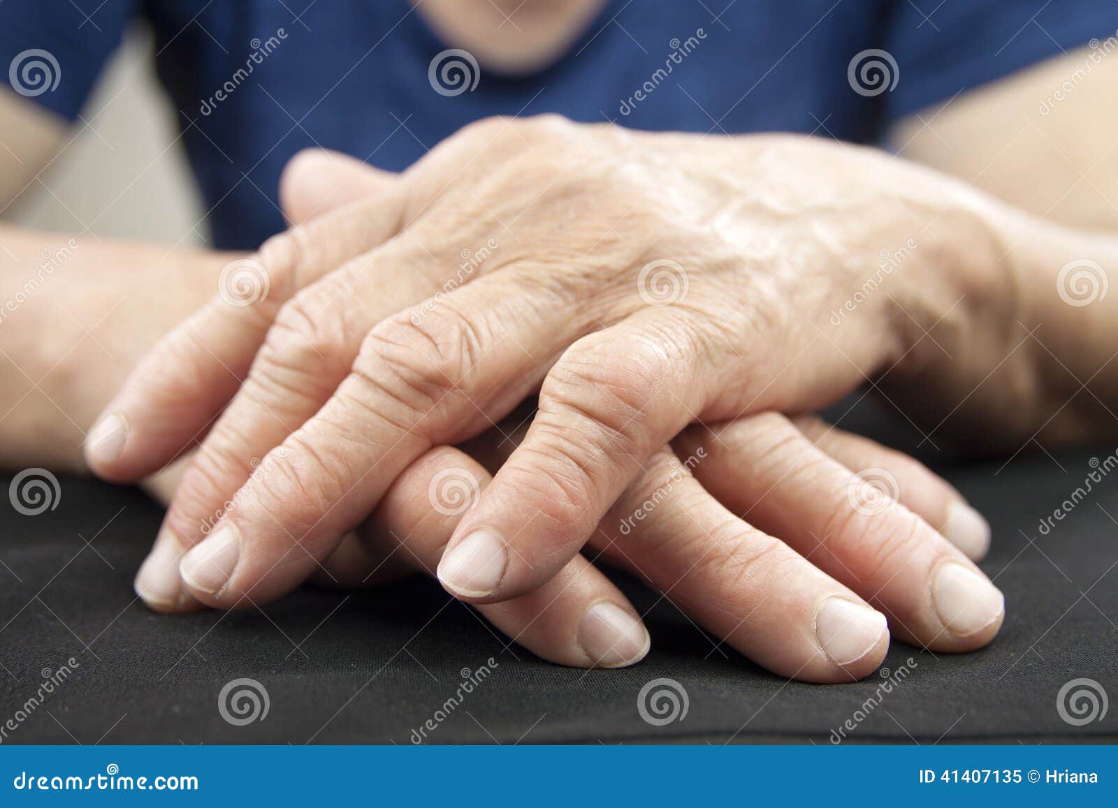 Bishops Hand Deformity