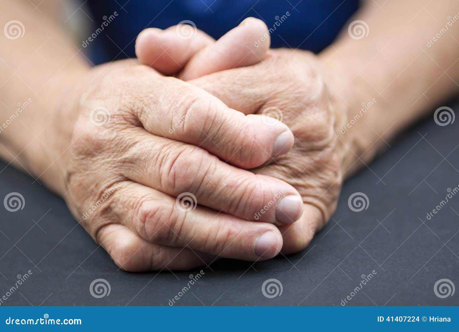 Rheumatoid Arthritis hands stock photo. Image of patient - 41407224