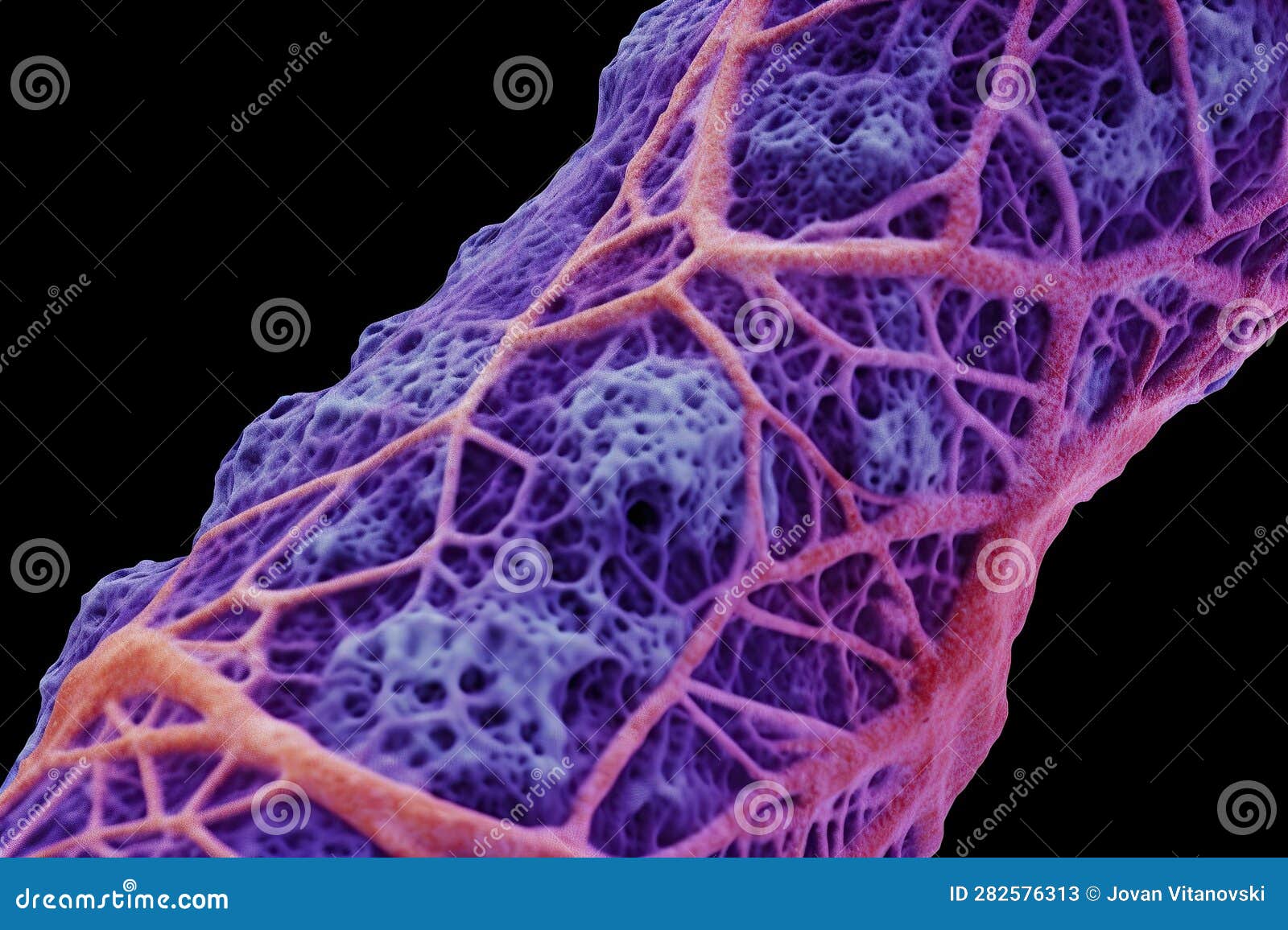 Rheumatoid Arthritis Under Microscope View Generative AI Stock ...