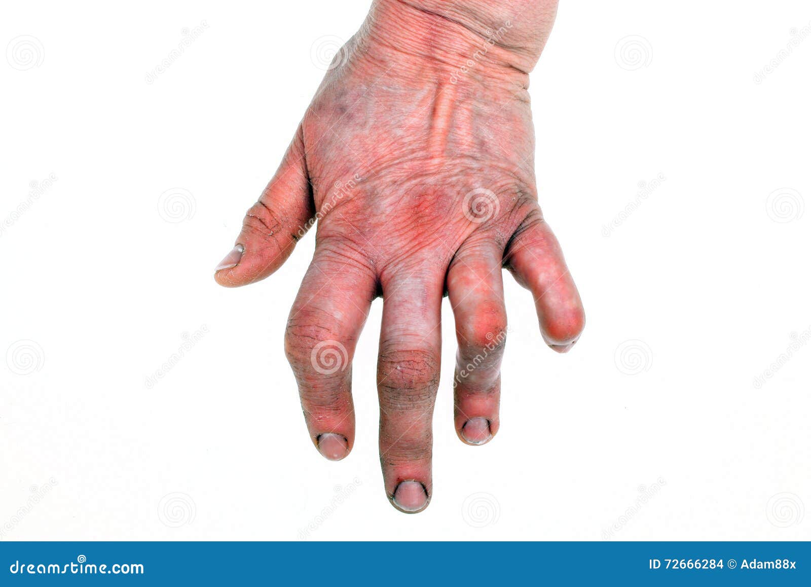 Hand Deformed From Rheumatoid Arthritis Stock Photography ...