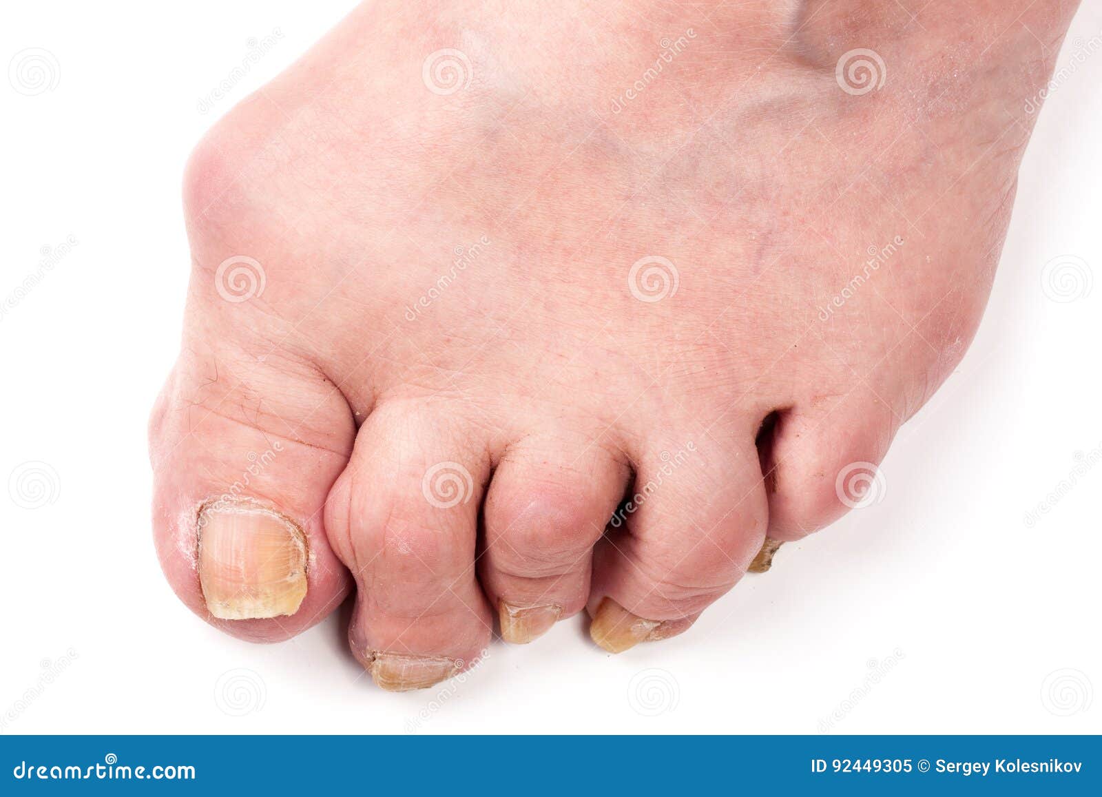 Foot Tumor Ultrasound