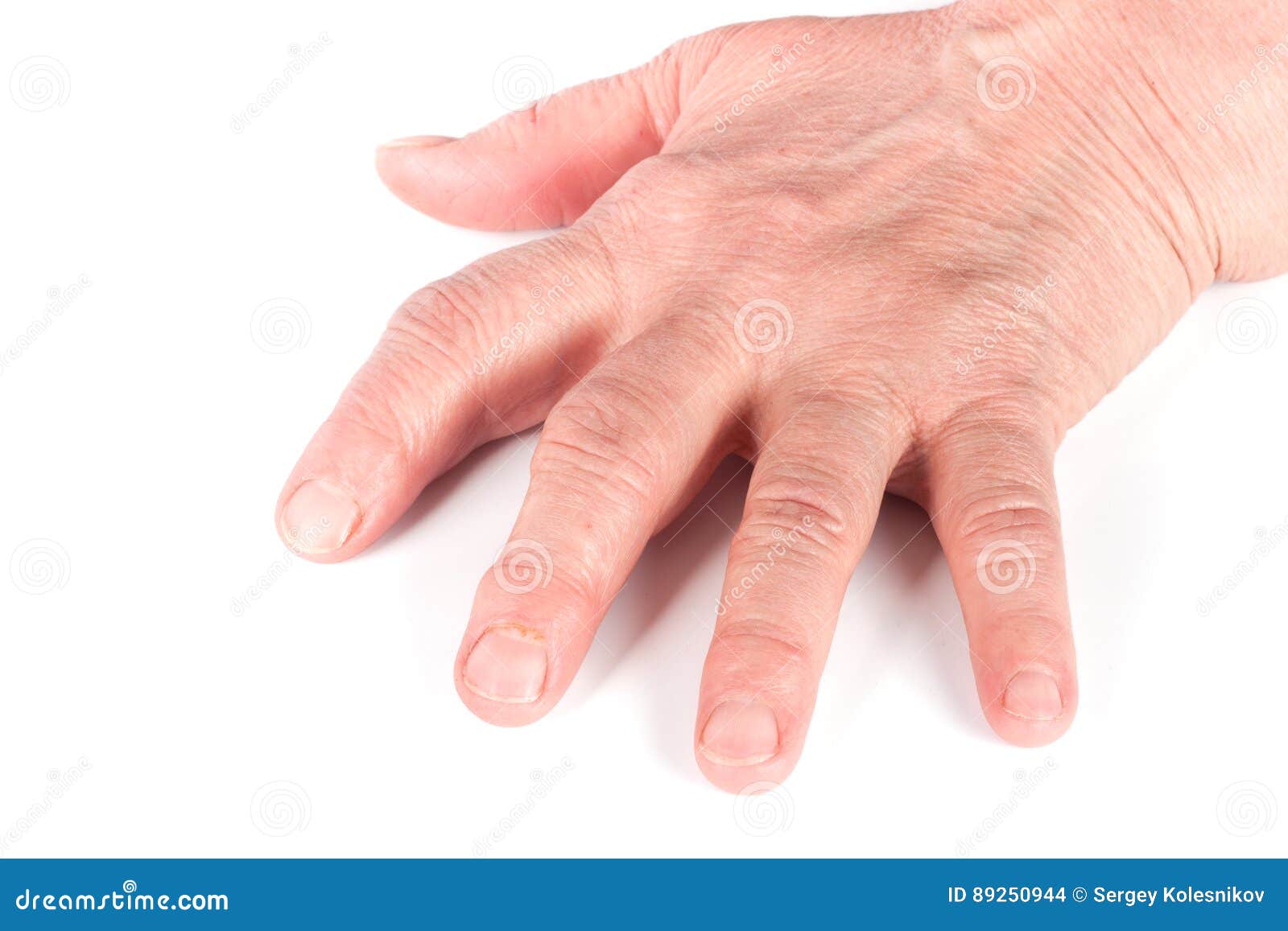 Rheumatoid Polyarthritis of Hands Isolated on White Background Stock ...