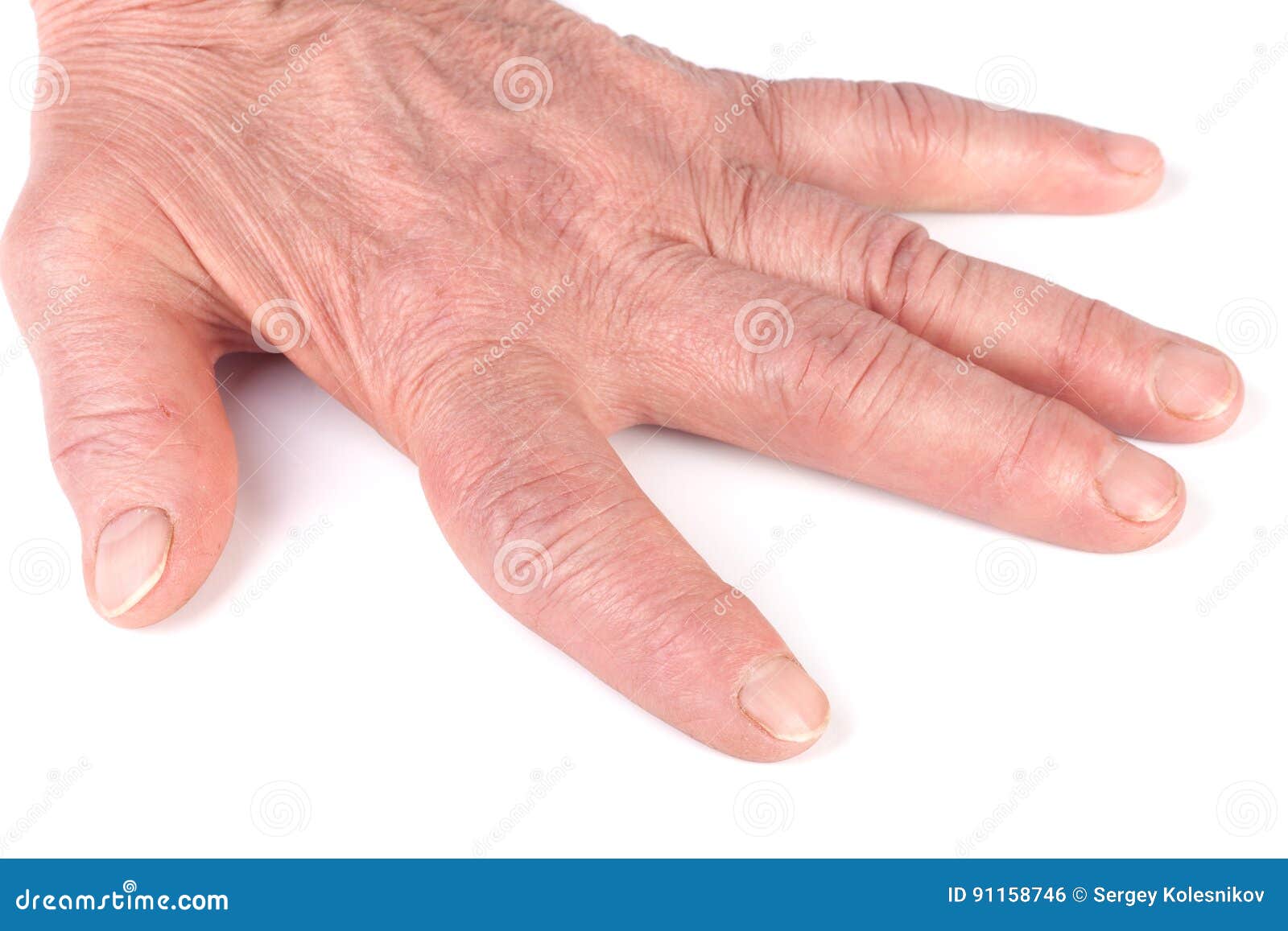 Rheumatoid Polyarthritis Of Hands Isolated On White Background Stock ...