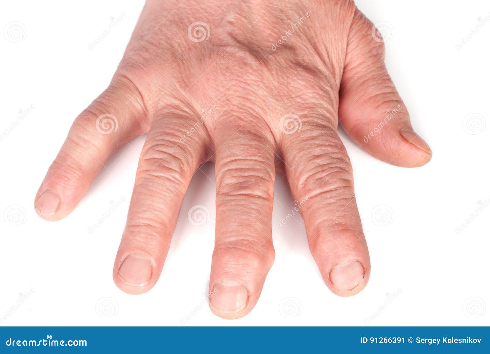 Rheumatoid Polyarthritis Of Hands Isolated On White Background Stock ...